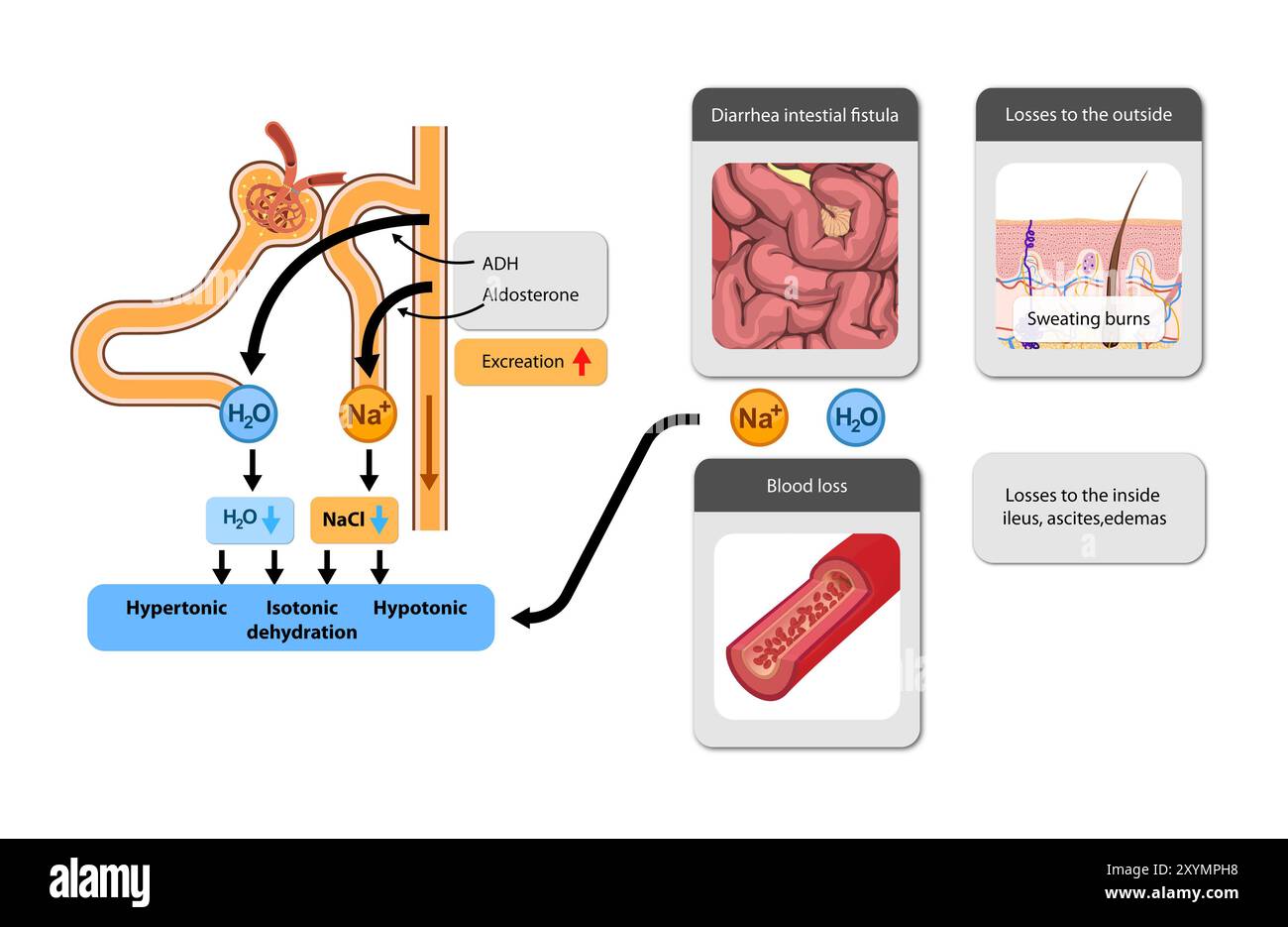 hypertonic, isotonic, and hypotonic dehydration, their causes, and the hormonal influence on ...