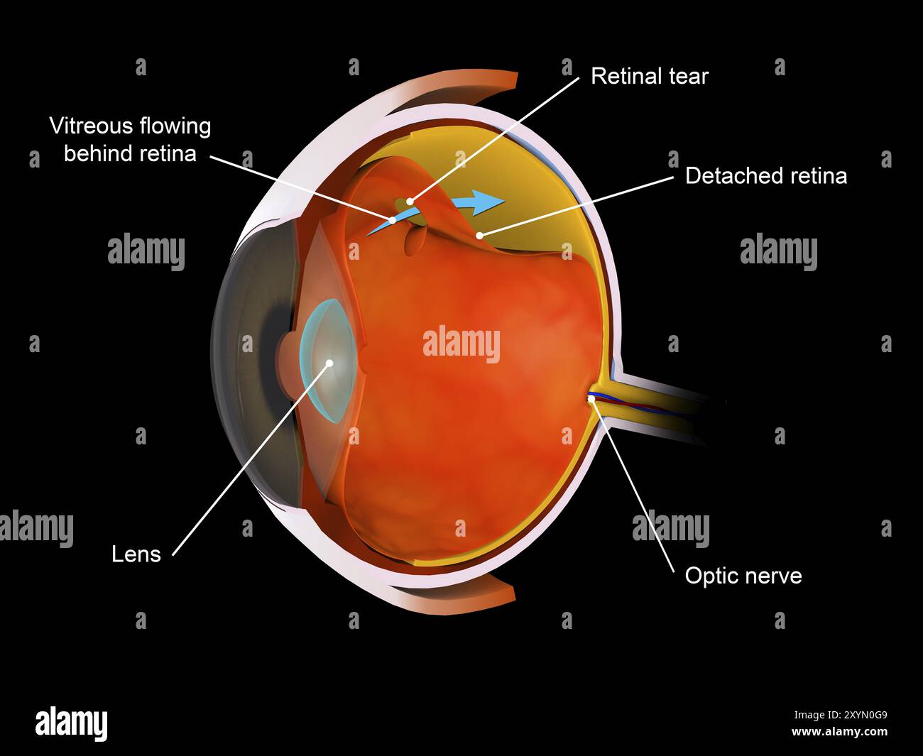 Detached retina hi-res stock photography and images - Alamy