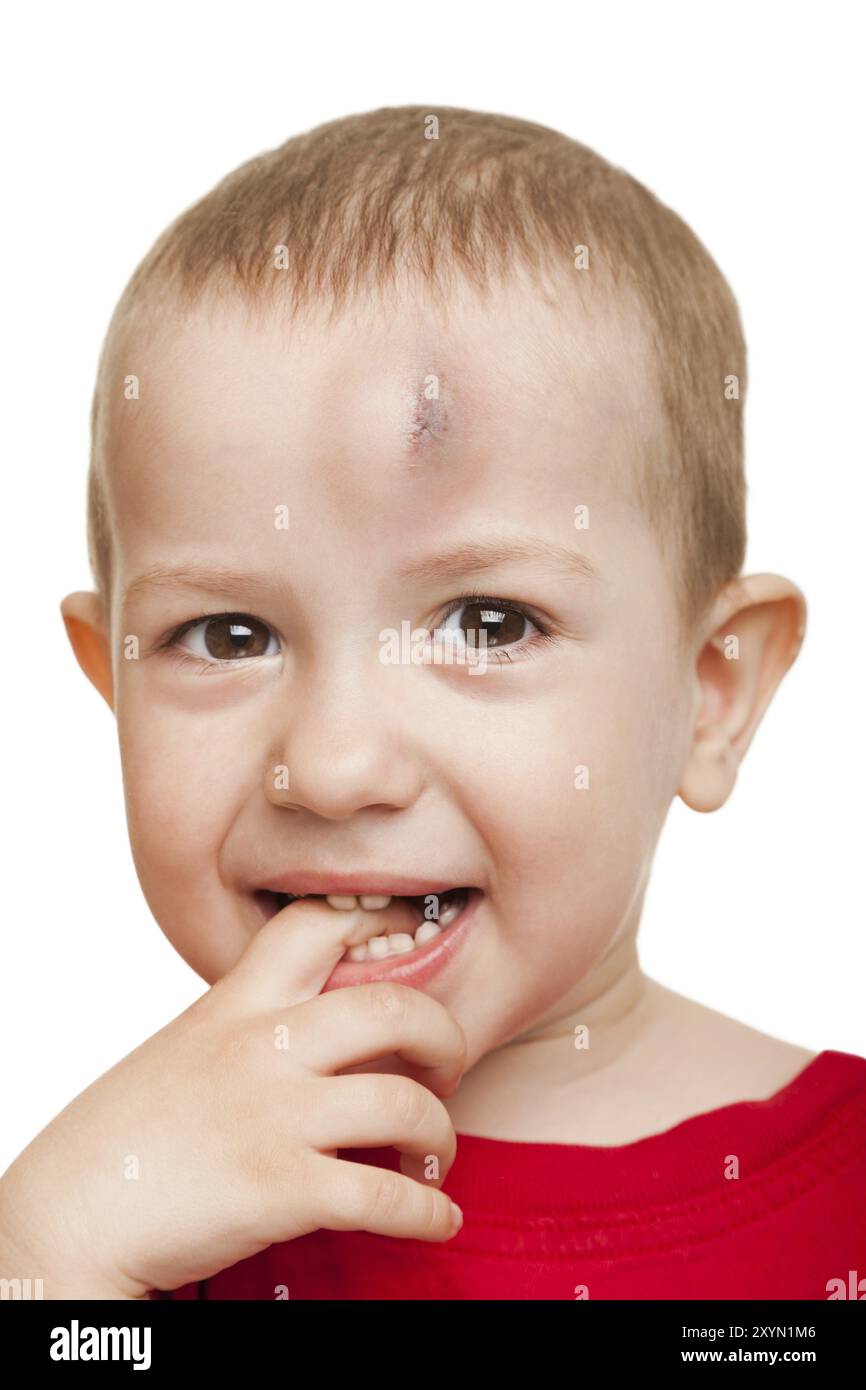Physical injury blood bruise on wound human child Stock Photo - Alamy