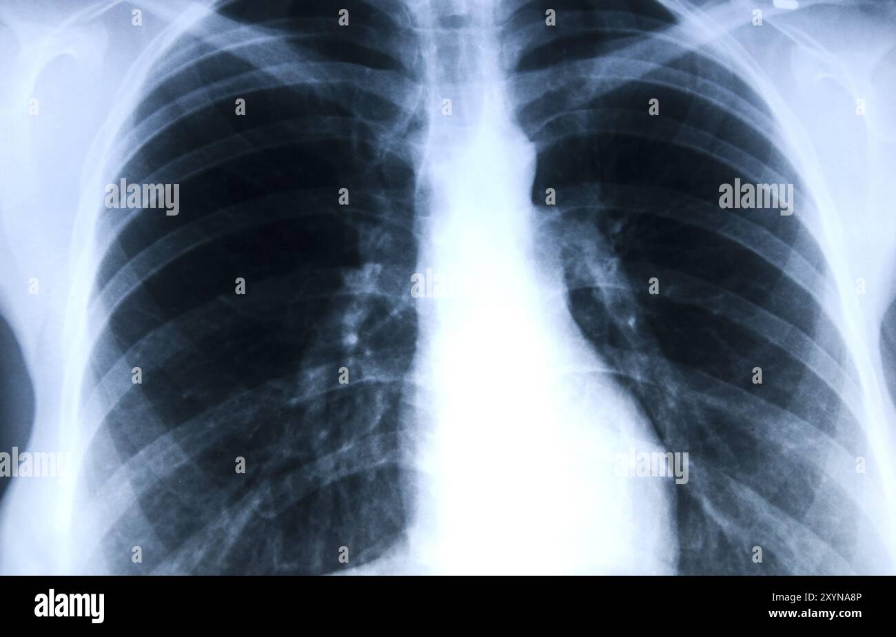 Torax hi-res stock photography and images - Alamy