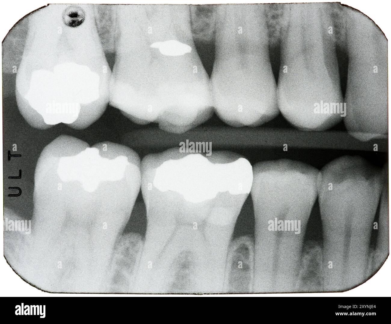 Dental X-rays of teeth in the back of the mouth, showing bright ...