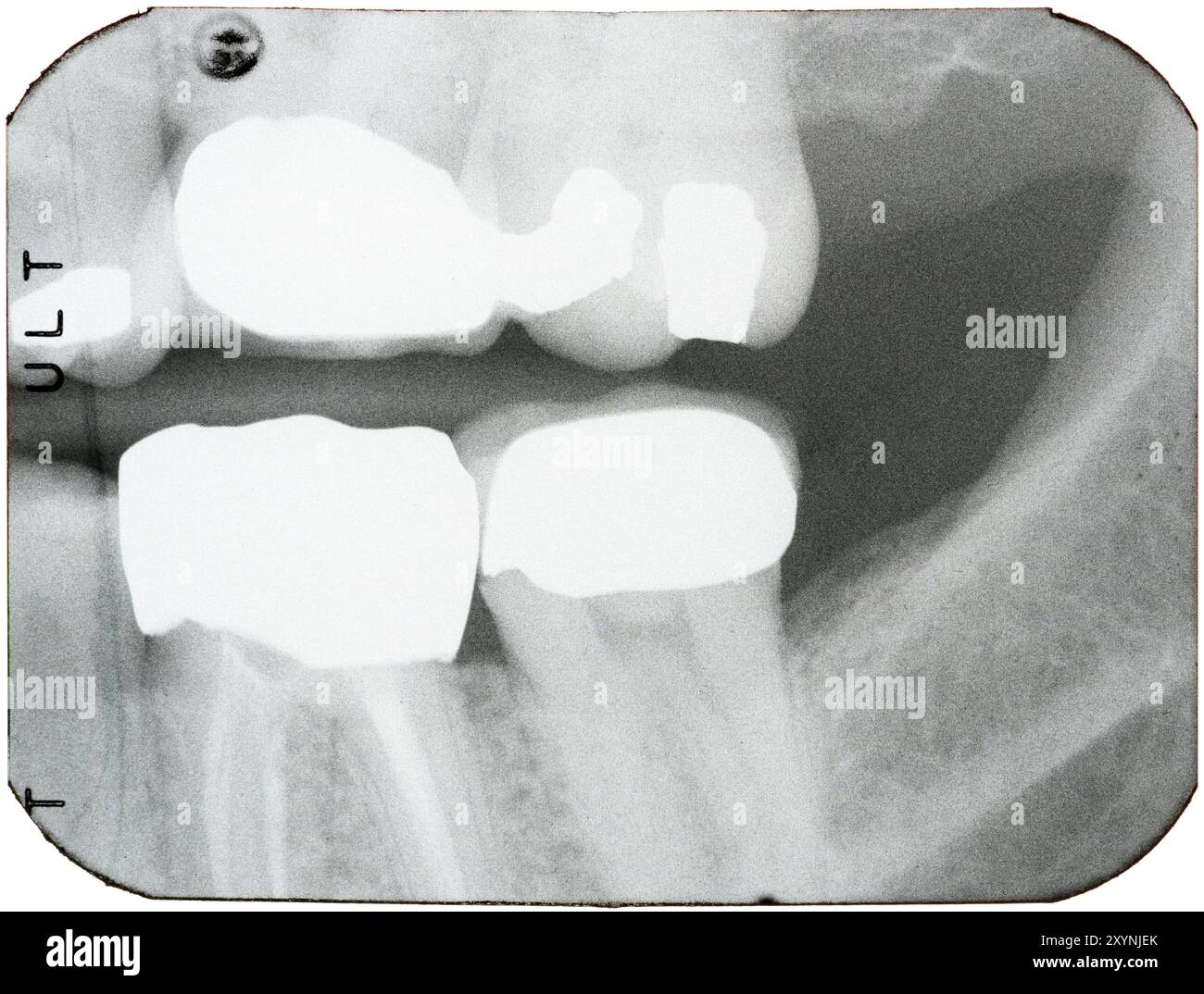 Dental X-rays of teeth in the back of the mouth, brightly showing ...