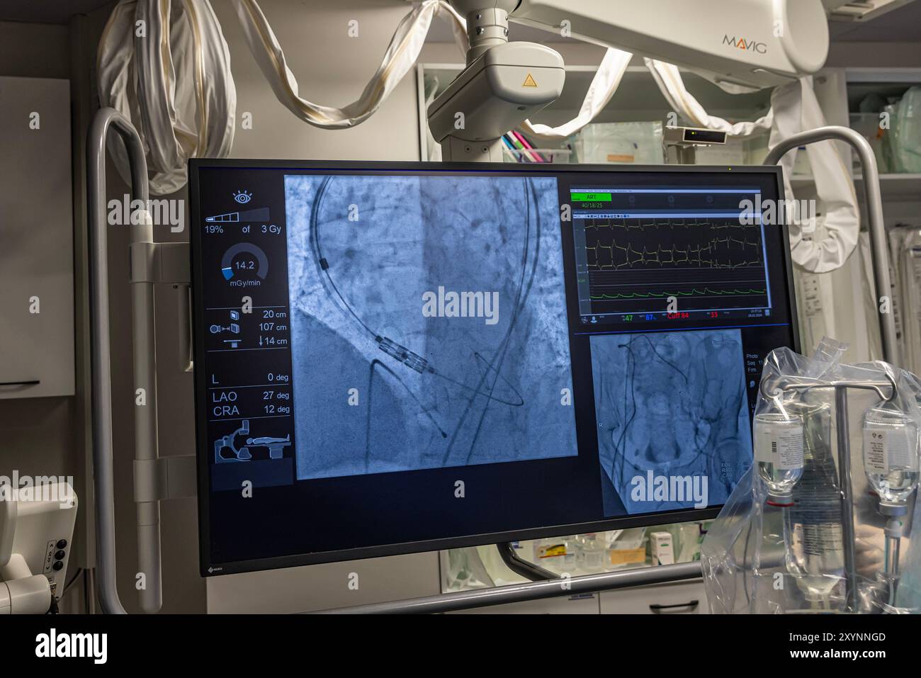 Istanbul, Turkey February 29, 2024; X-ray for valvular replacement with ...