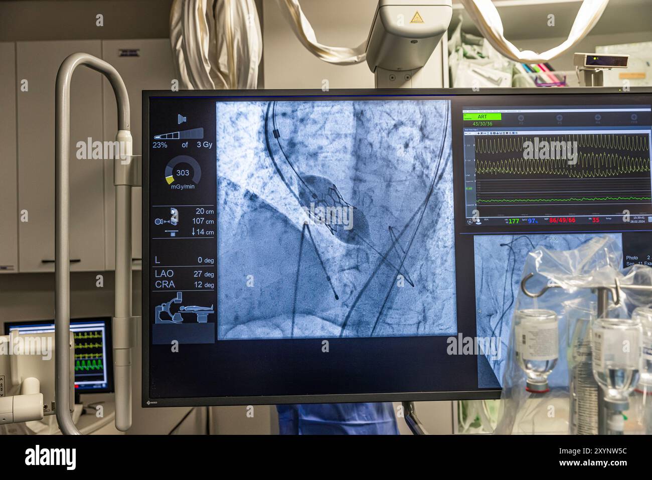 Istanbul, Turkey February 29, 2024; X-ray for valvular replacement with ...