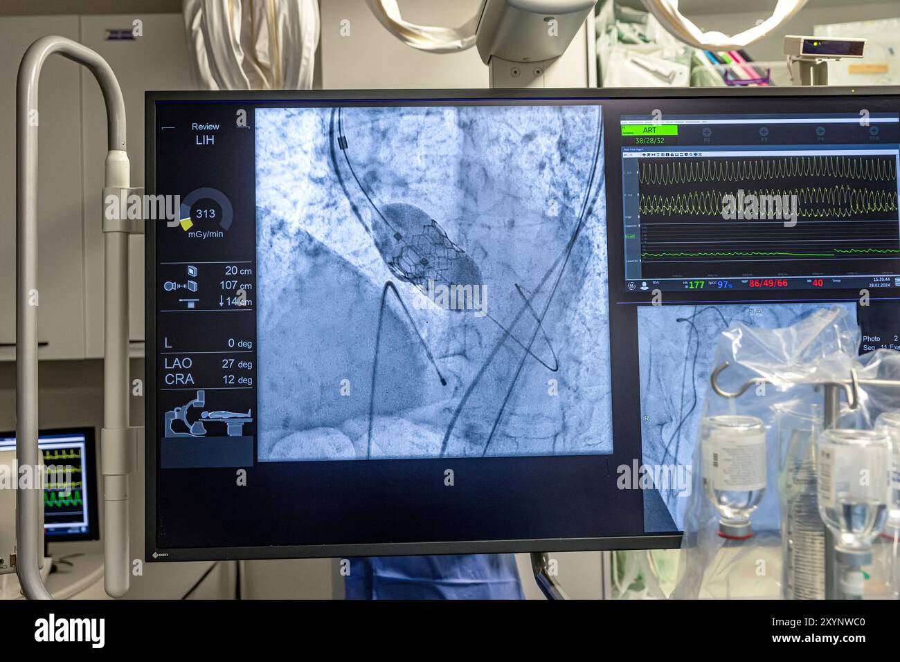 Istanbul, Turkey February 29, 2024; X-ray for valvular replacement with ...