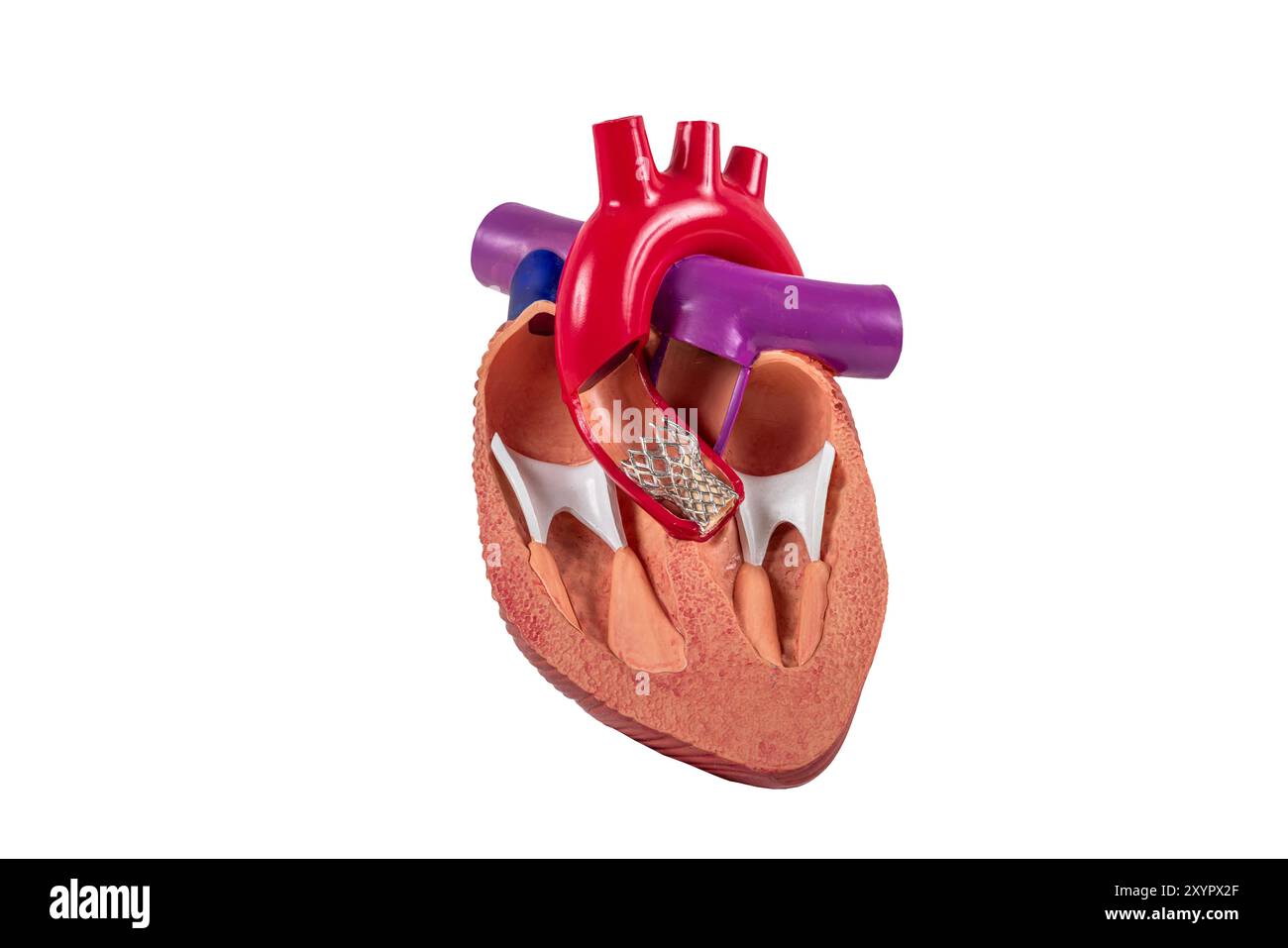 Cardiac model of Transcatheter aortic valve implantation (TAVI) for ...