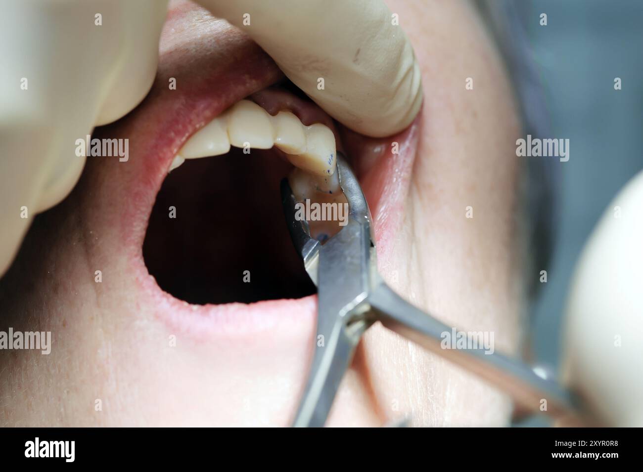 Forceps for pulling teeth in a patient's mouth Stock Photo - Alamy