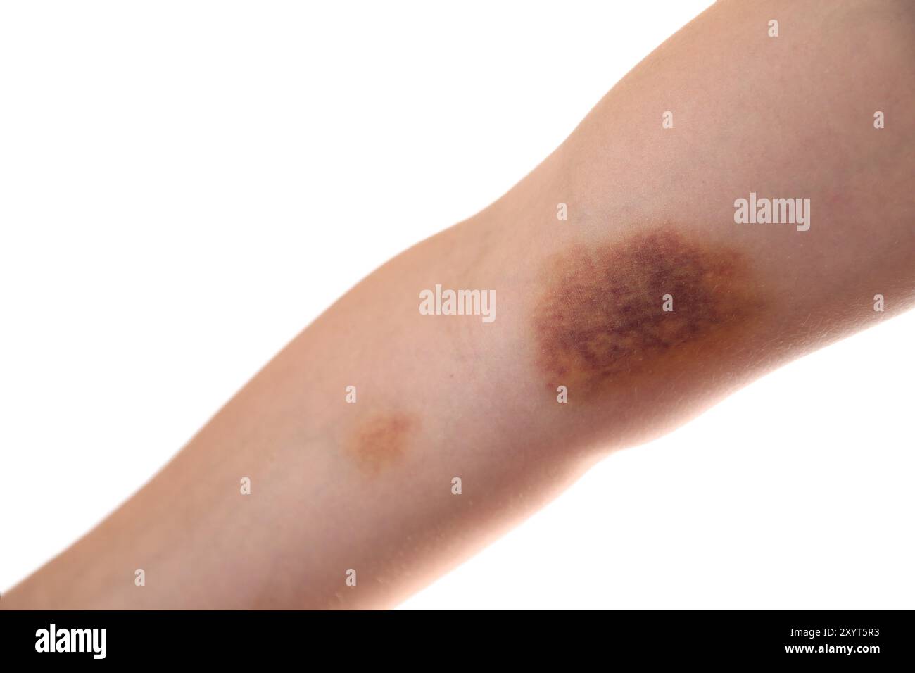Medical bruise on arm hi-res stock photography and images - Alamy