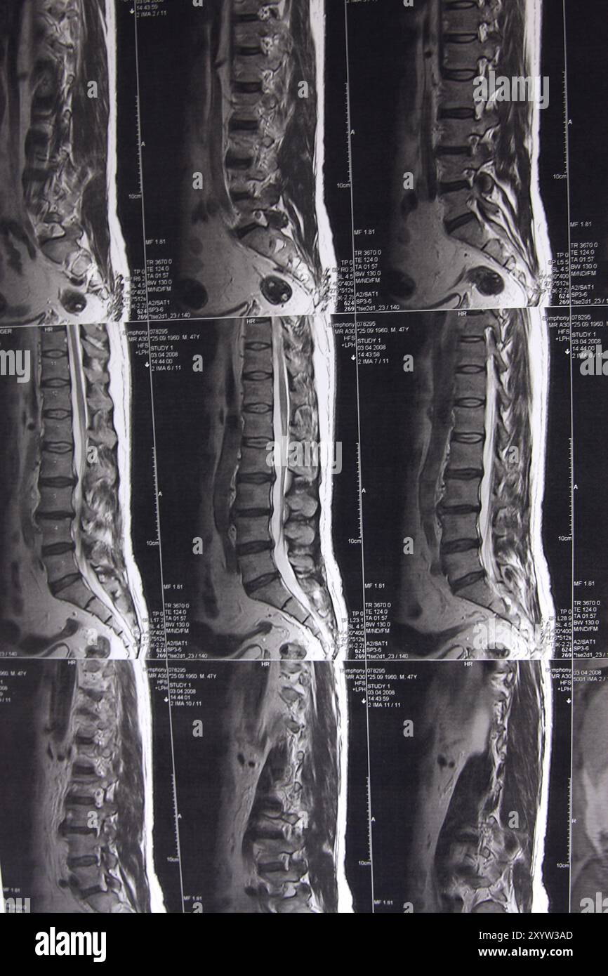 Slipped disc x ray hi-res stock photography and images - Alamy