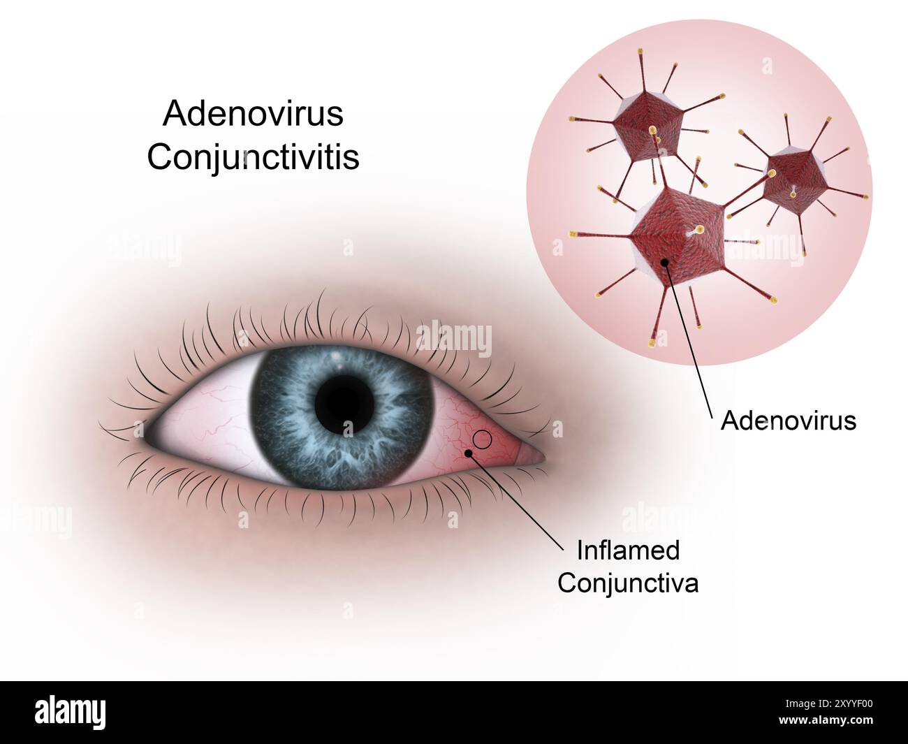 Viral conjunctivitis hi-res stock photography and images - Alamy