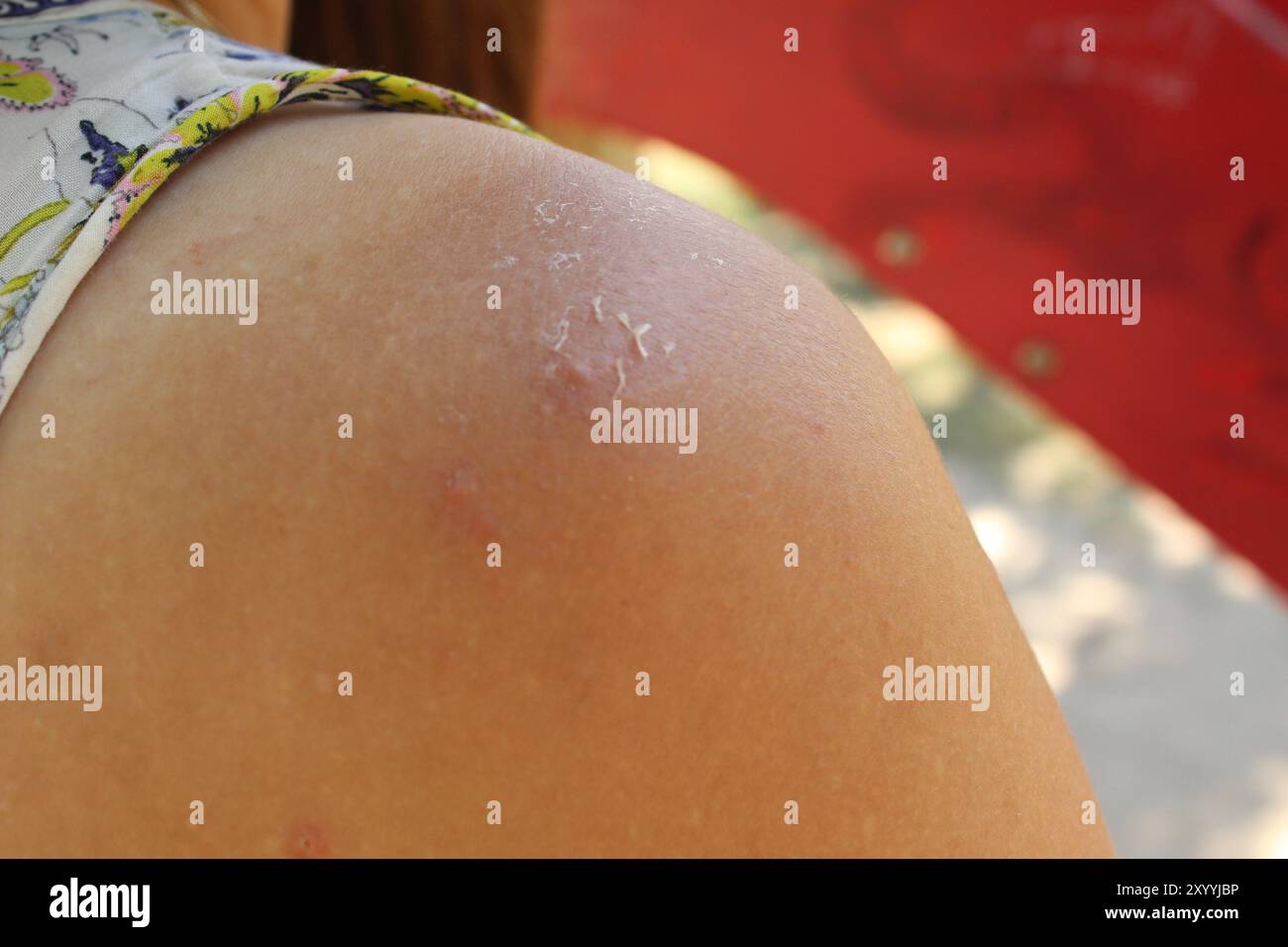 pimple on the forearm. Pimples comedones on shoulder forearm girl close ...