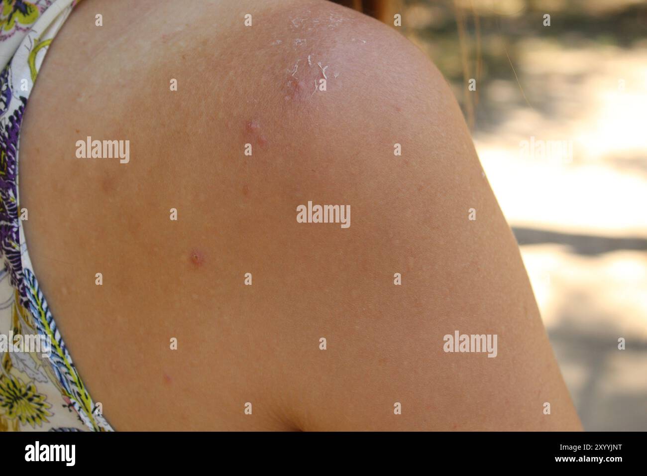 pimple on the forearm. Skin problems on the back and arms. Post ...