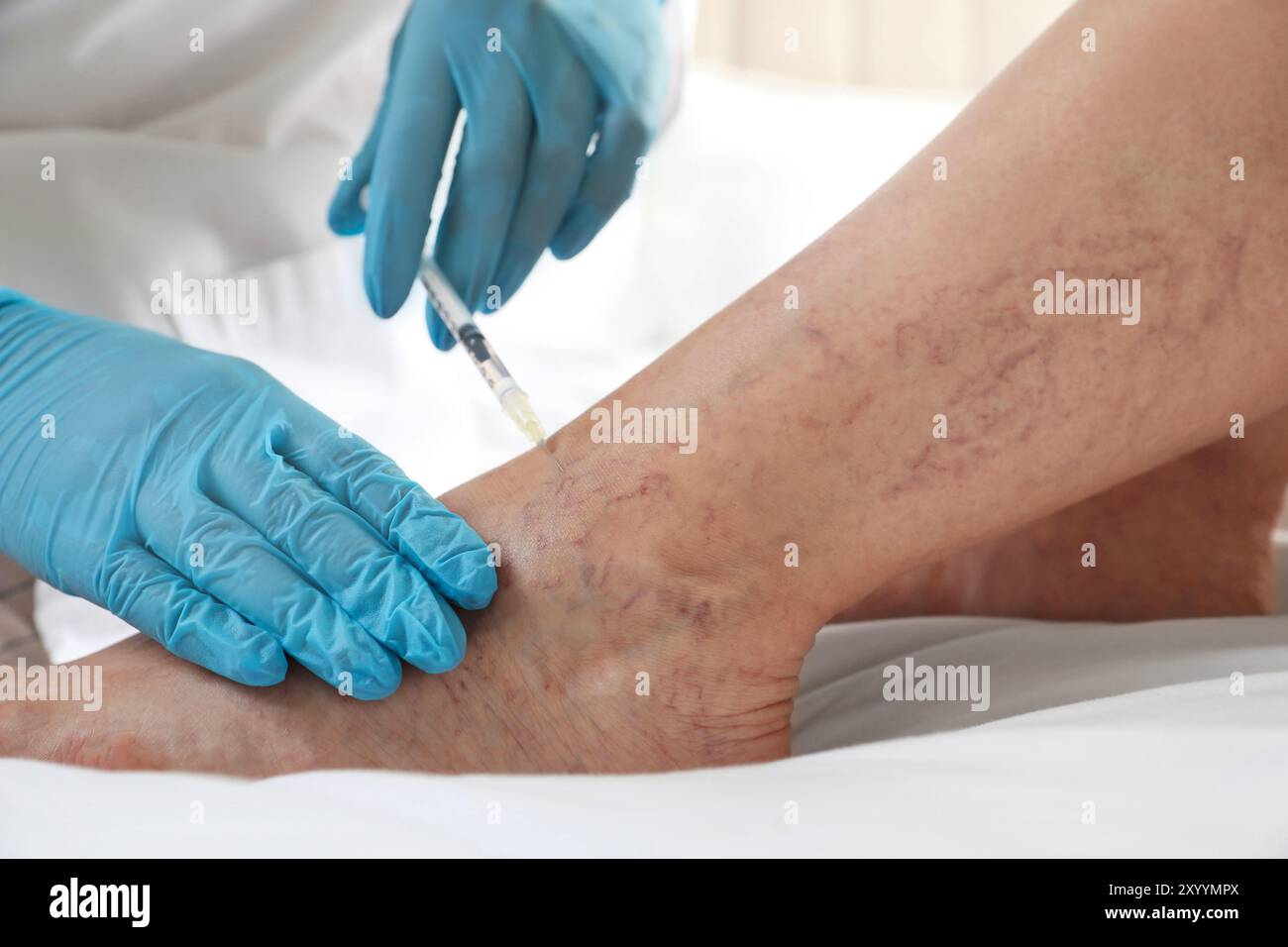 Varicose veins treatment. Doctor giving injection to patient indoors ...