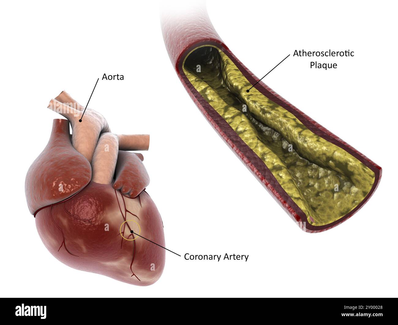 Heart attack artwork hi-res stock photography and images - Alamy