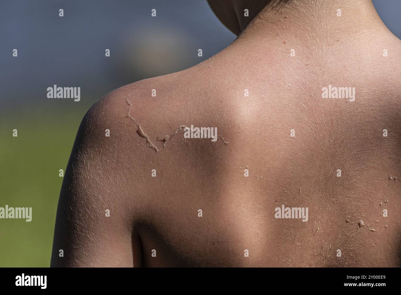 Skin peeling off the back of a small kid after being sunburned Stock ...