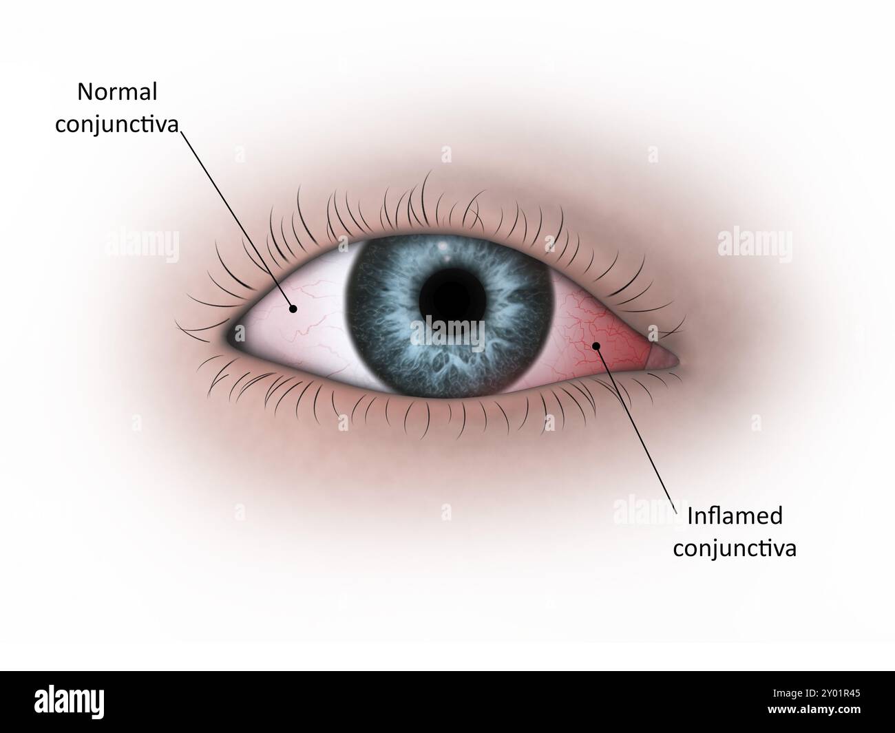 Conjunctivitis depiction hi-res stock photography and images - Alamy