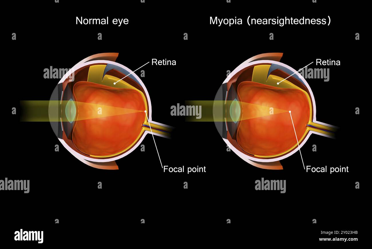 Comparison of a normal eye and an eye with myopia Stock Photo - Alamy