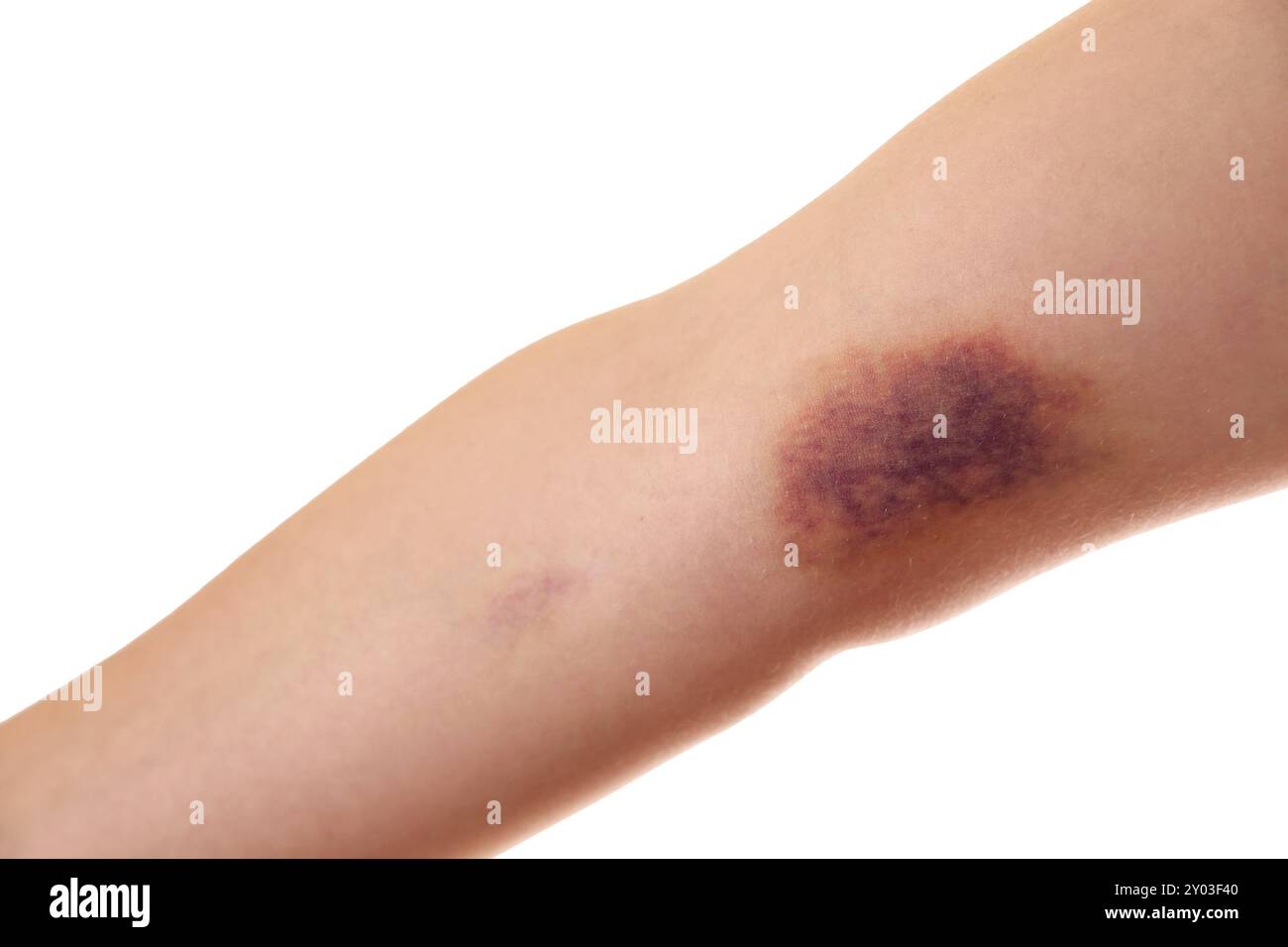 Medical bruise on arm hi-res stock photography and images - Alamy