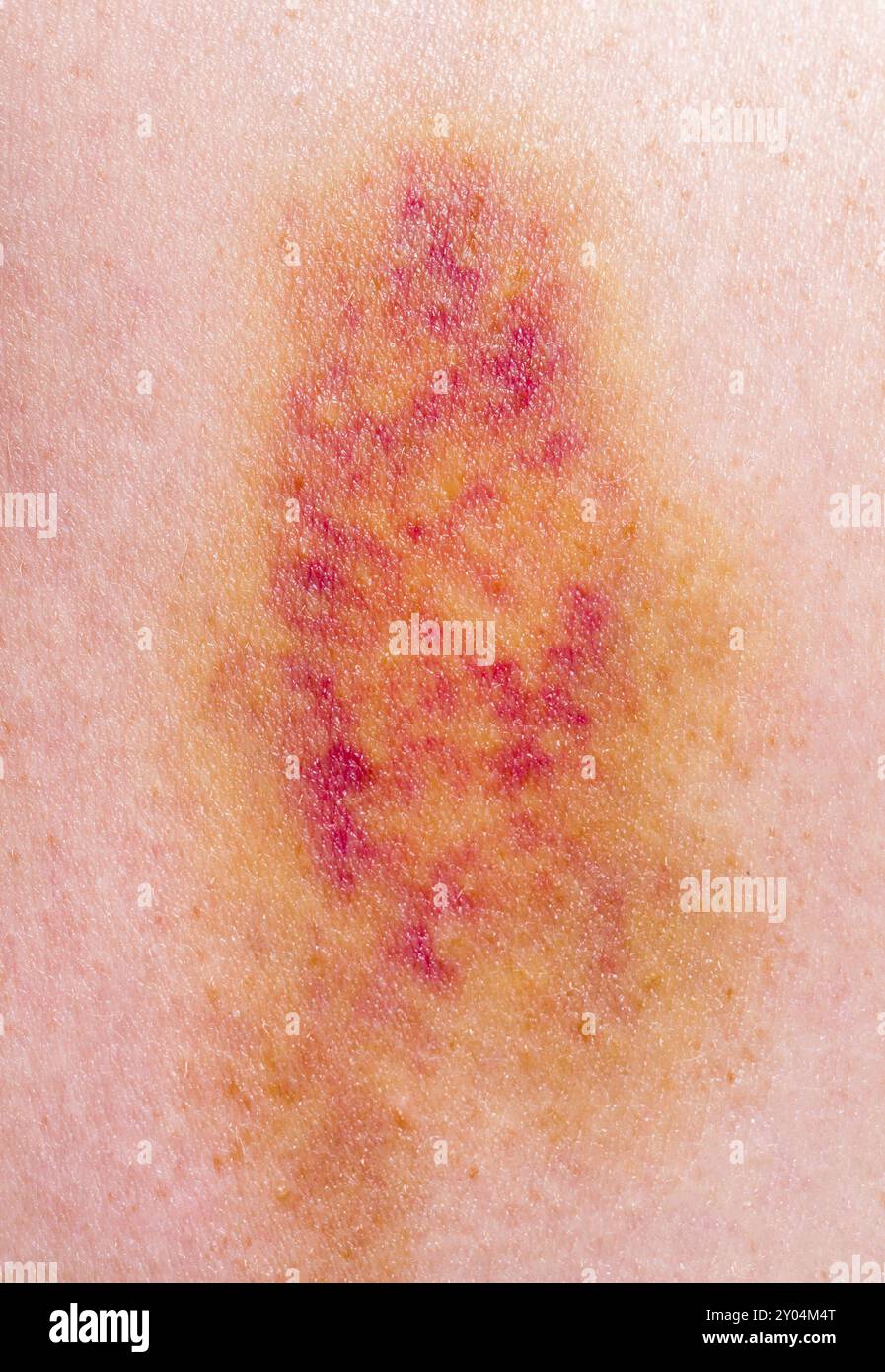 Closeup on a Bruise on wounded woman leg skin Stock Photo - Alamy