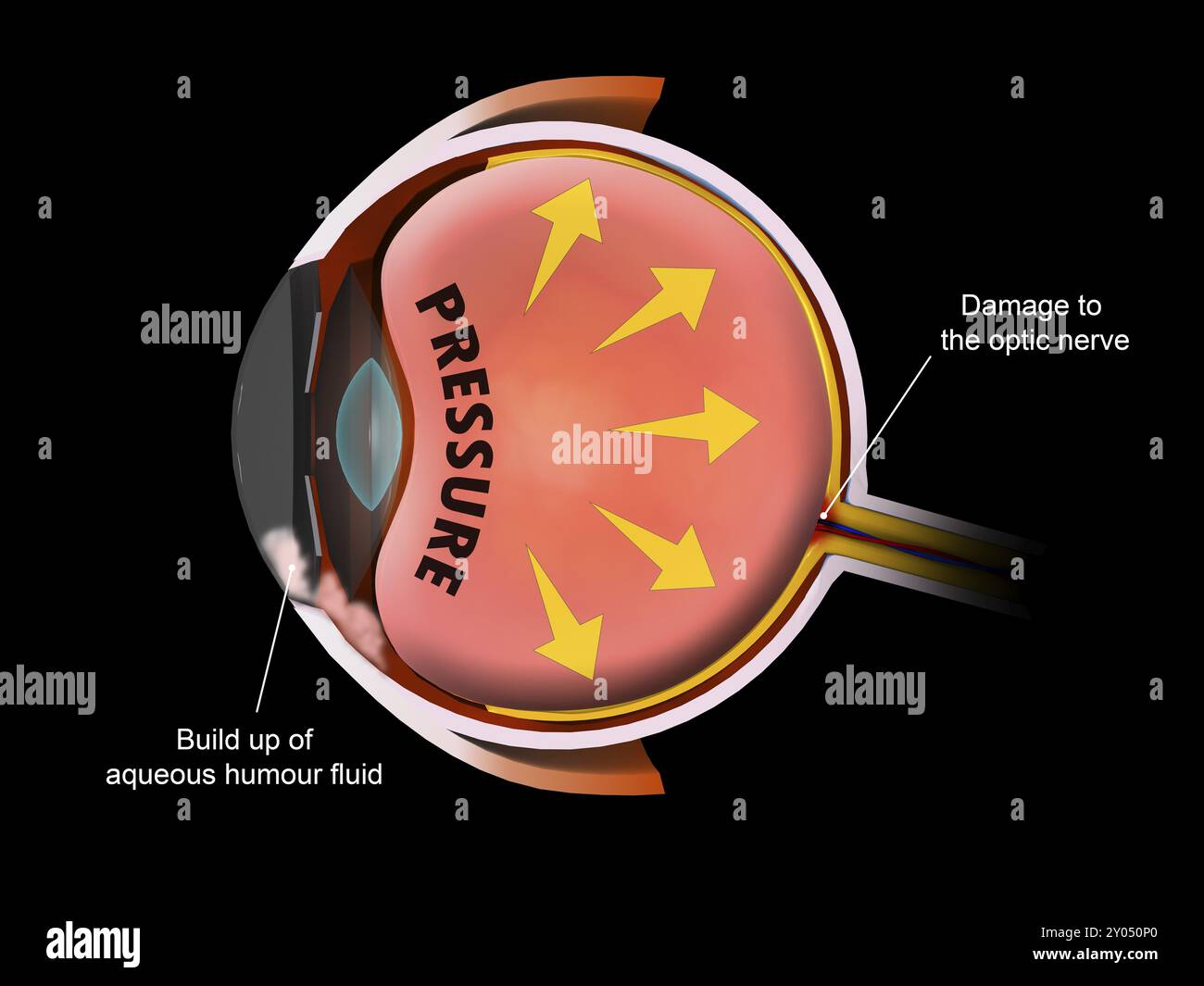Medical illustration showing increased pressure in the eyeball, leading ...