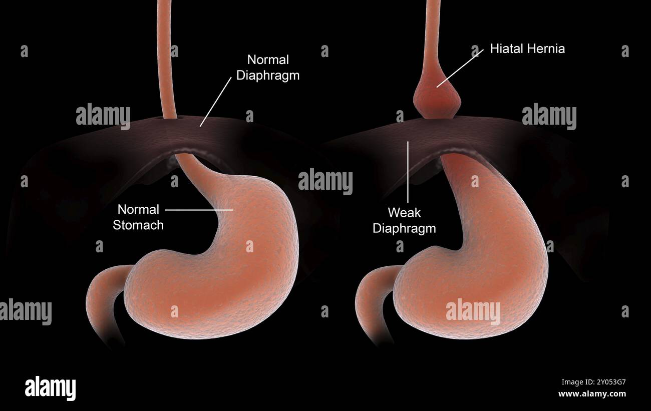 Hiatal hernia hi-res stock photography and images - Alamy