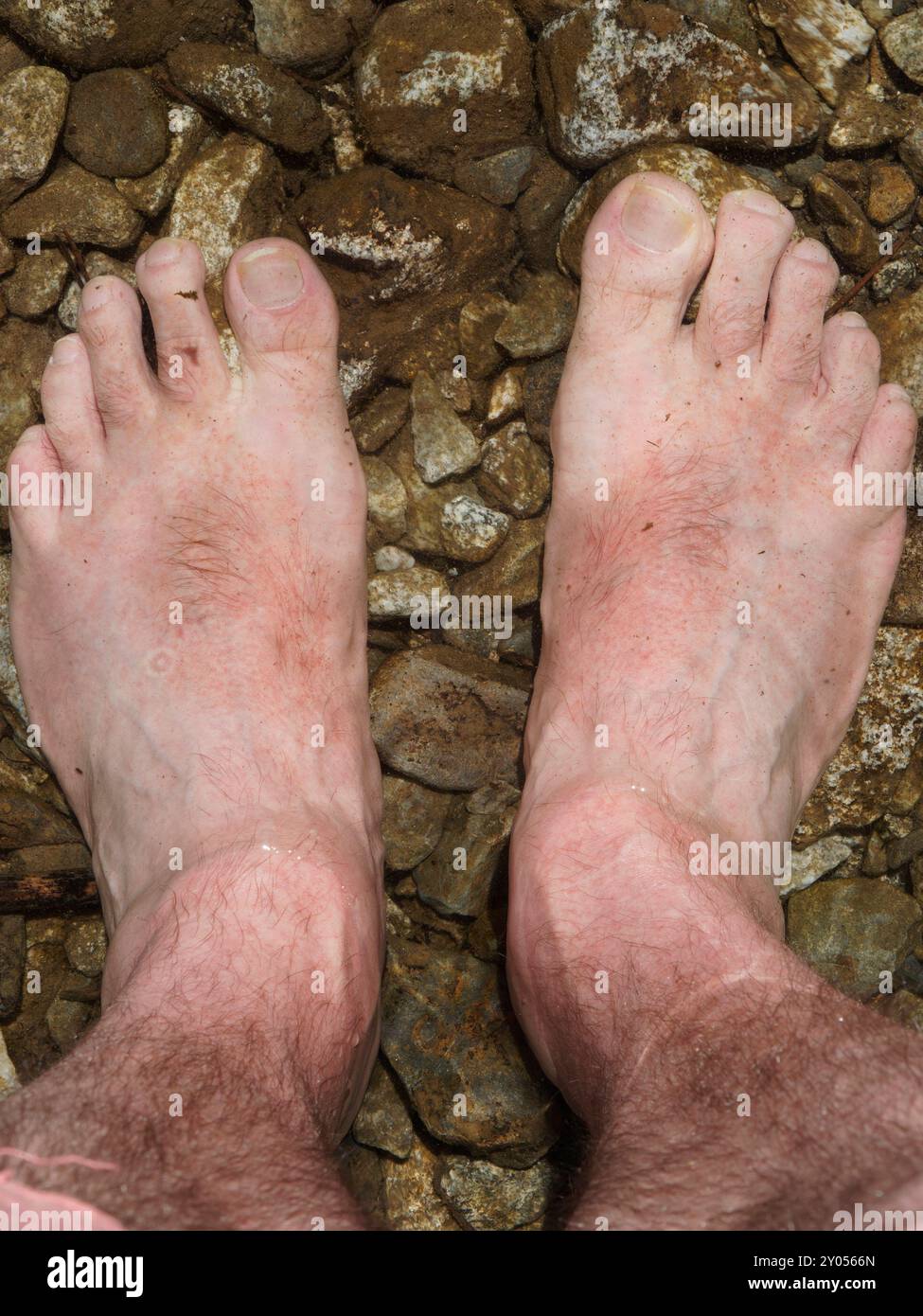 Foot cryotherapy hi-res stock photography and images - Alamy