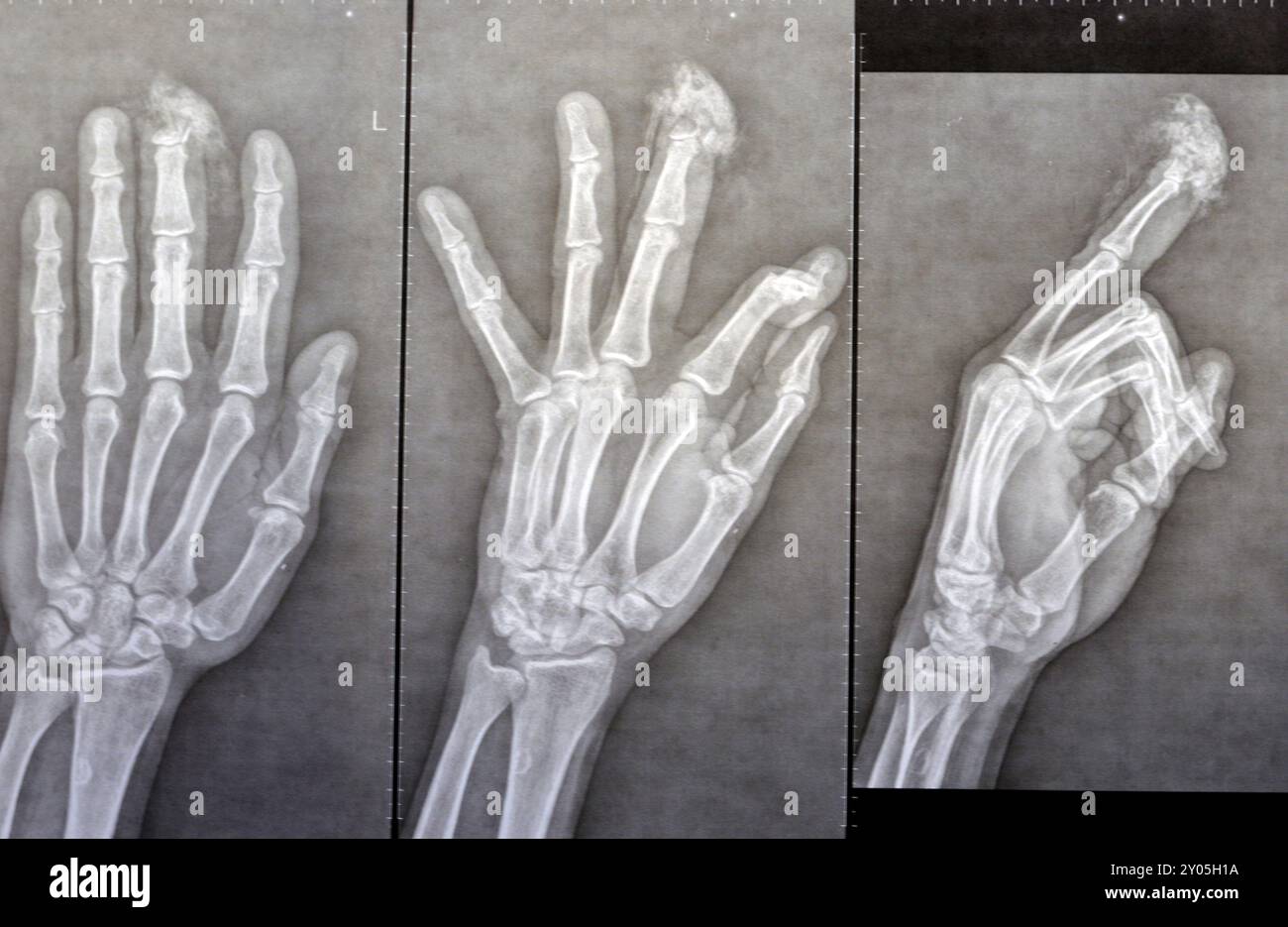 Plain X-Ray reveals distal tip amputation of distal phalanx of the ...