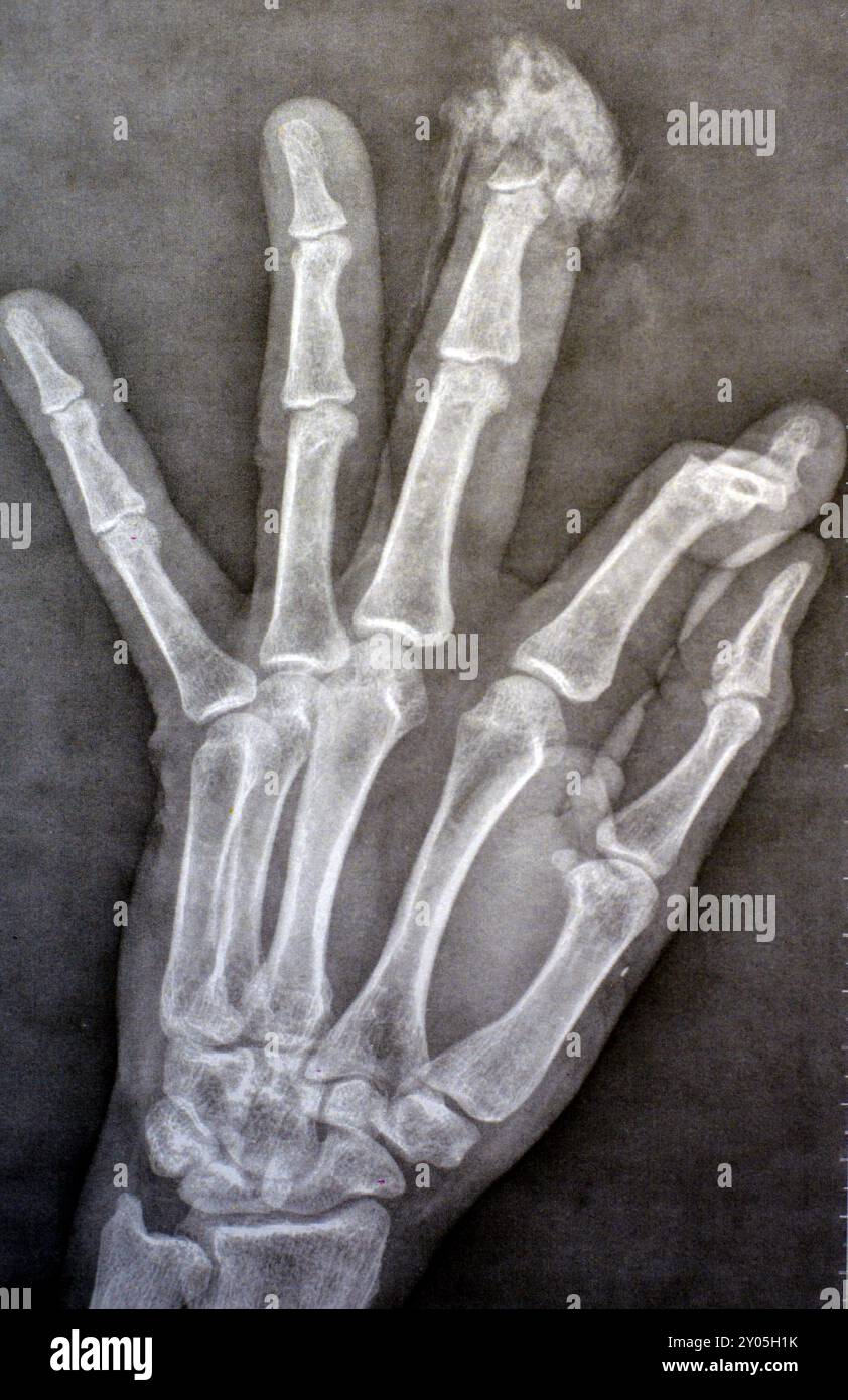 Plain X-Ray reveals distal tip amputation of distal phalanx of the ...