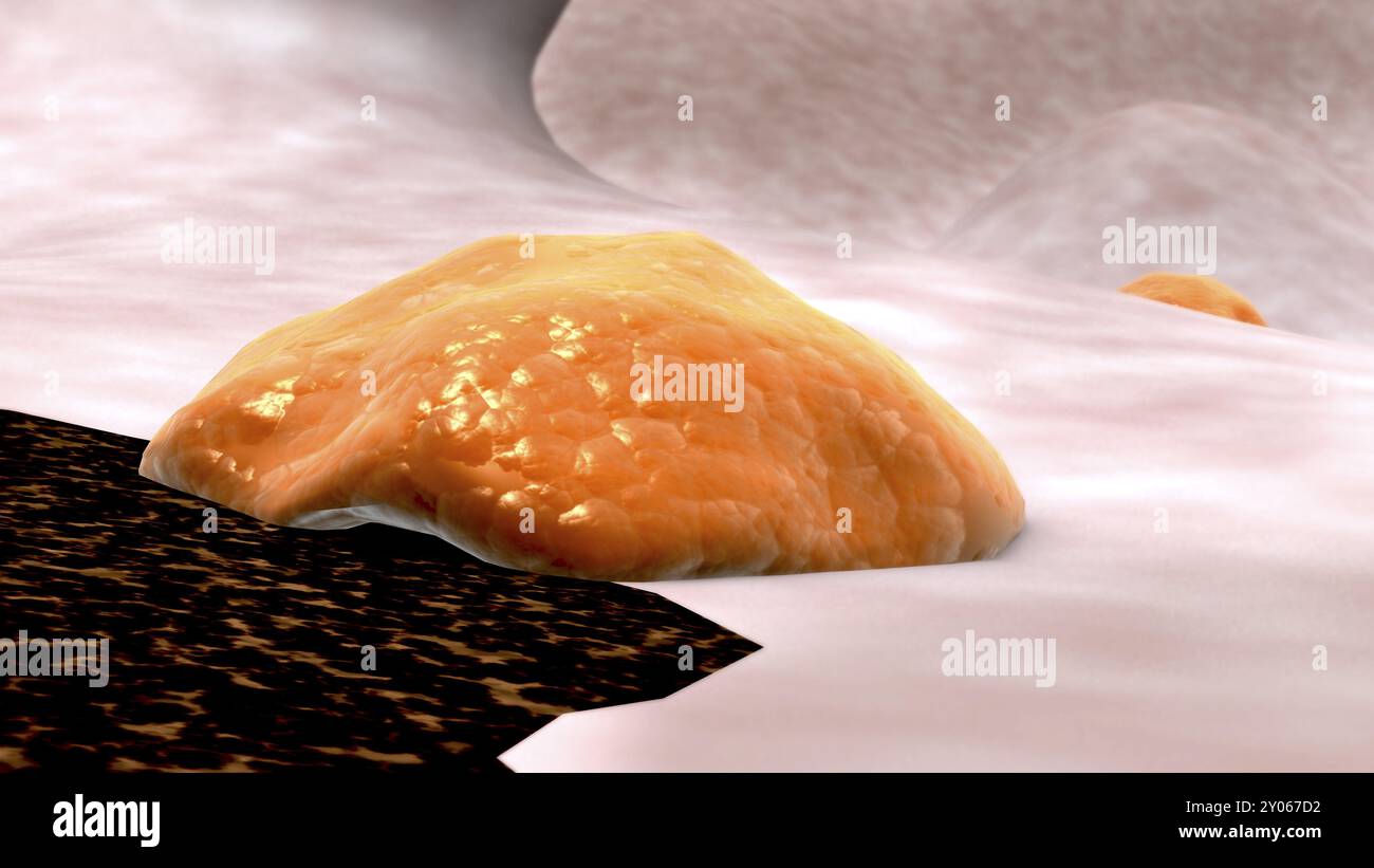 Osteoclast breaking down bone tissue Stock Photo - Alamy Osteoclast breaking down bone tissue Stock Photo - Alamy