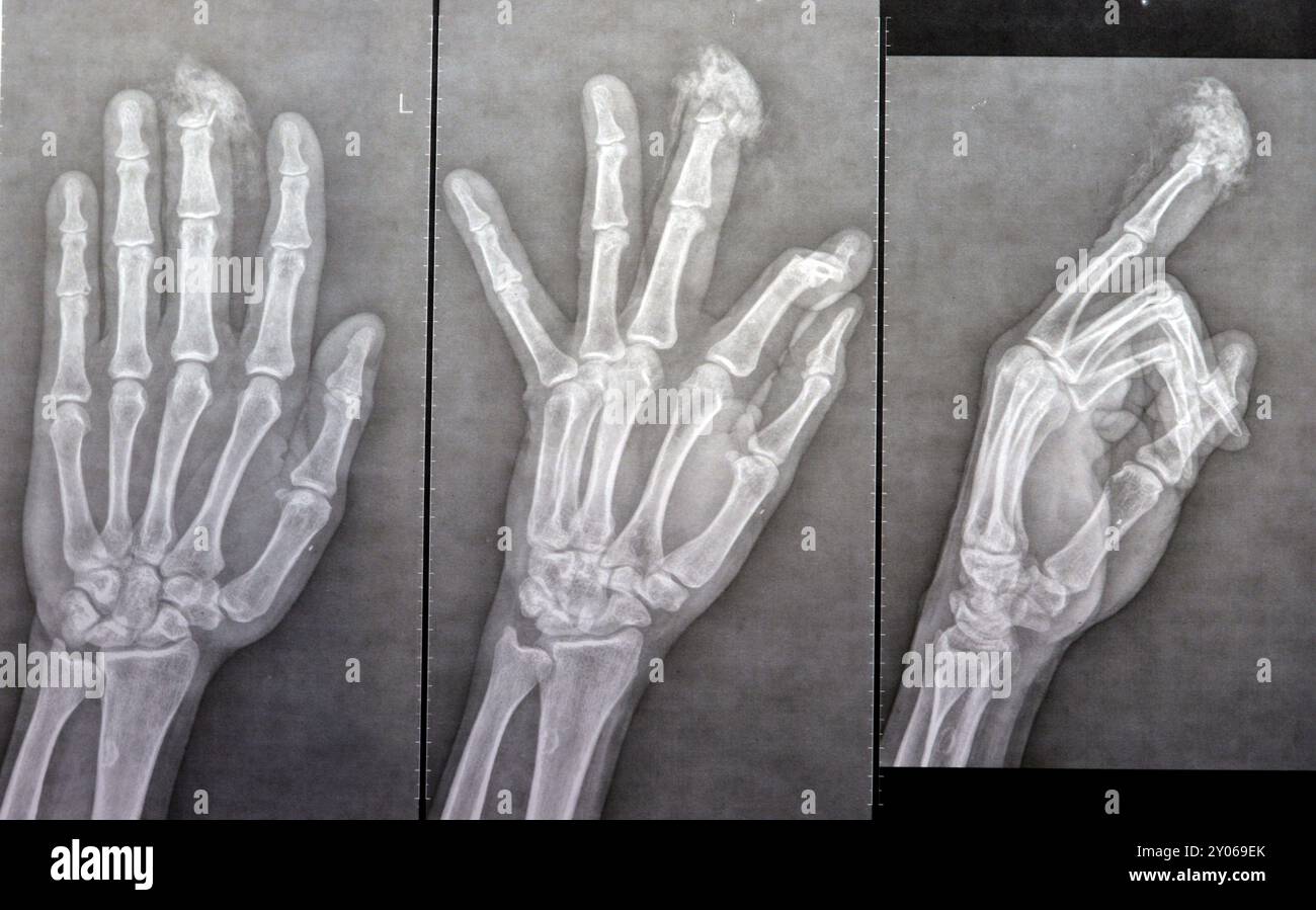 Plain X-Ray reveals distal tip amputation of distal phalanx of the ...