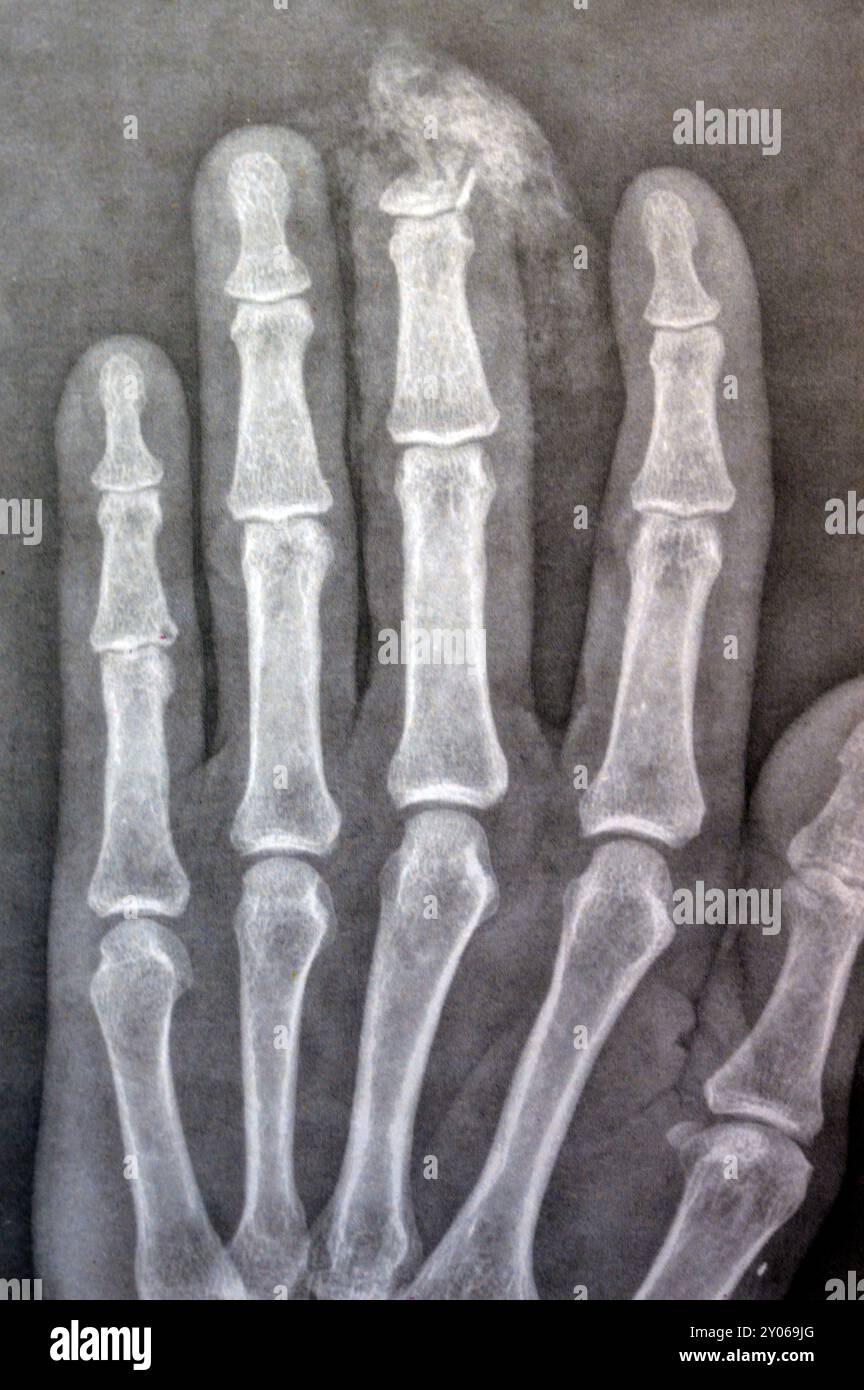 Plain X-Ray reveals distal tip amputation of distal phalanx of the ...