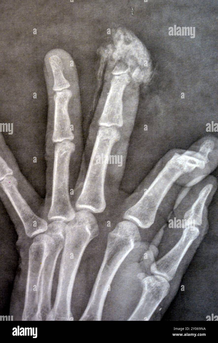 Plain X-Ray reveals distal tip amputation of distal phalanx of the ...