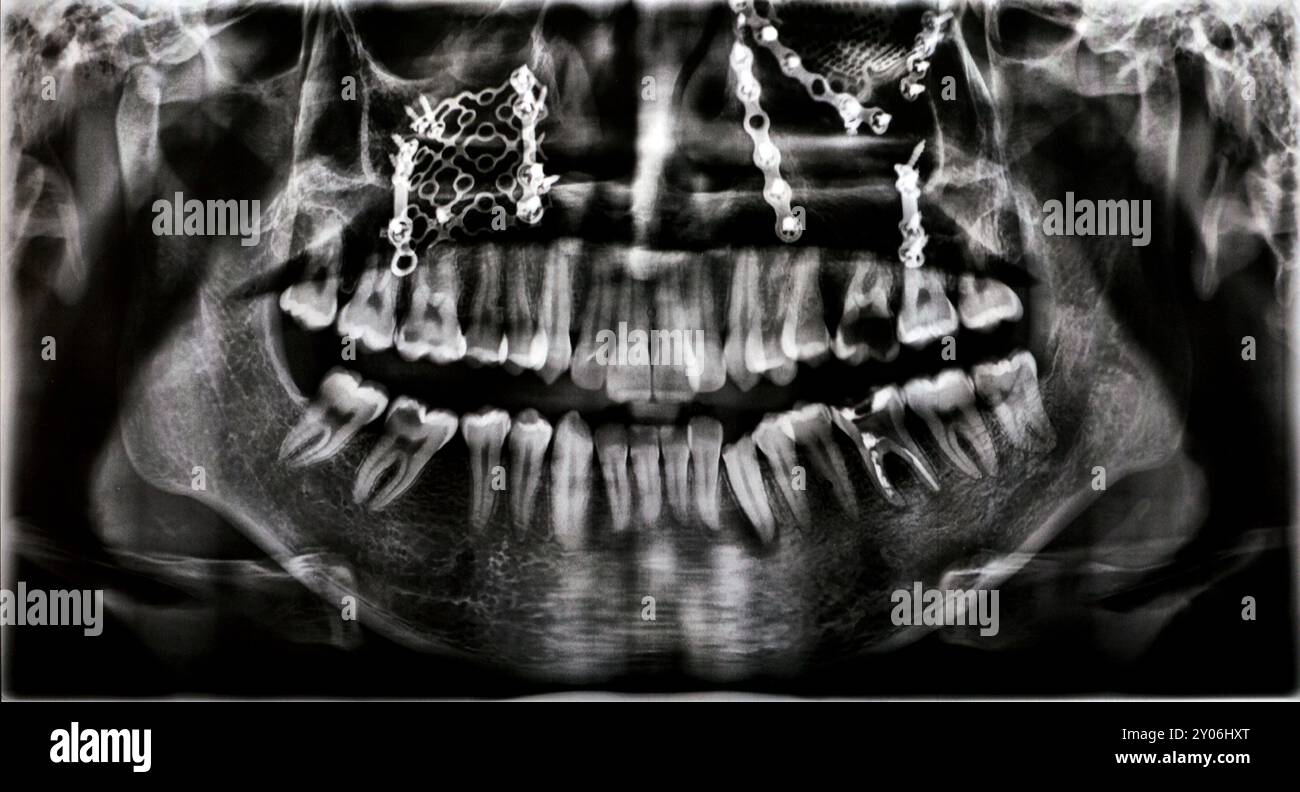 Panoramic X Ray shows multiple plates, screws for maxillary fixation of ...