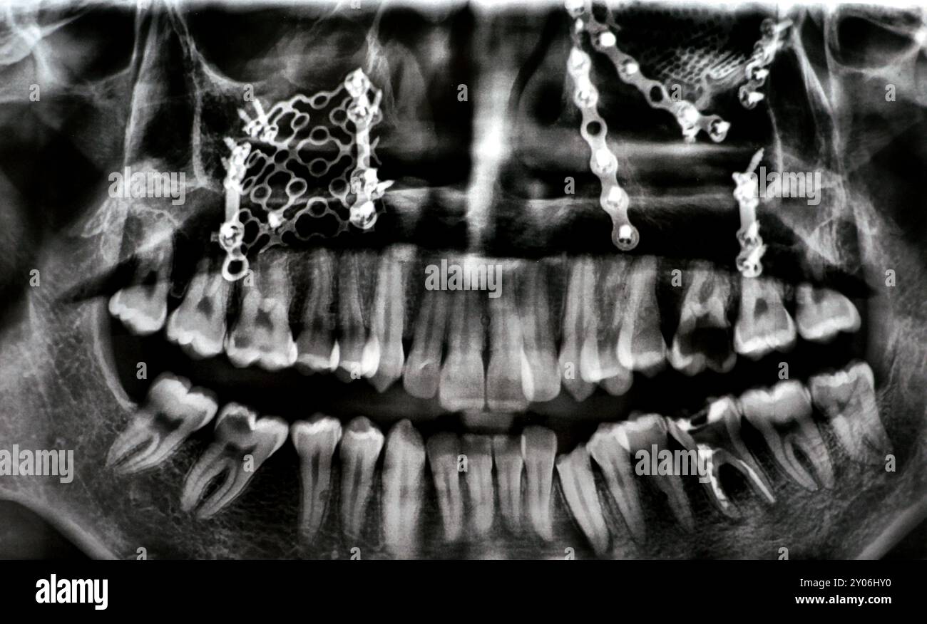 Panoramic X Ray shows multiple plates, screws for maxillary fixation of ...