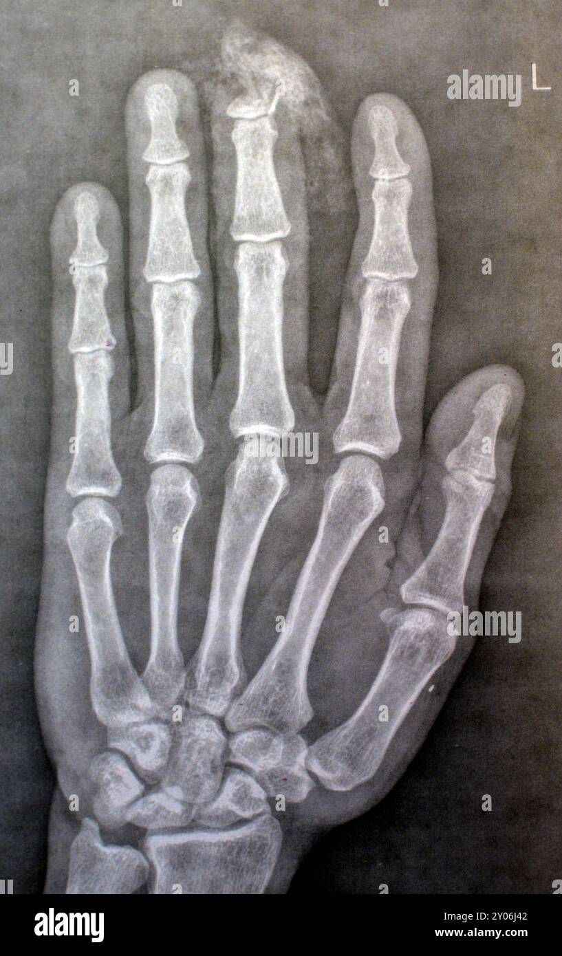 Plain X-Ray reveals distal tip amputation of distal phalanx of the ...