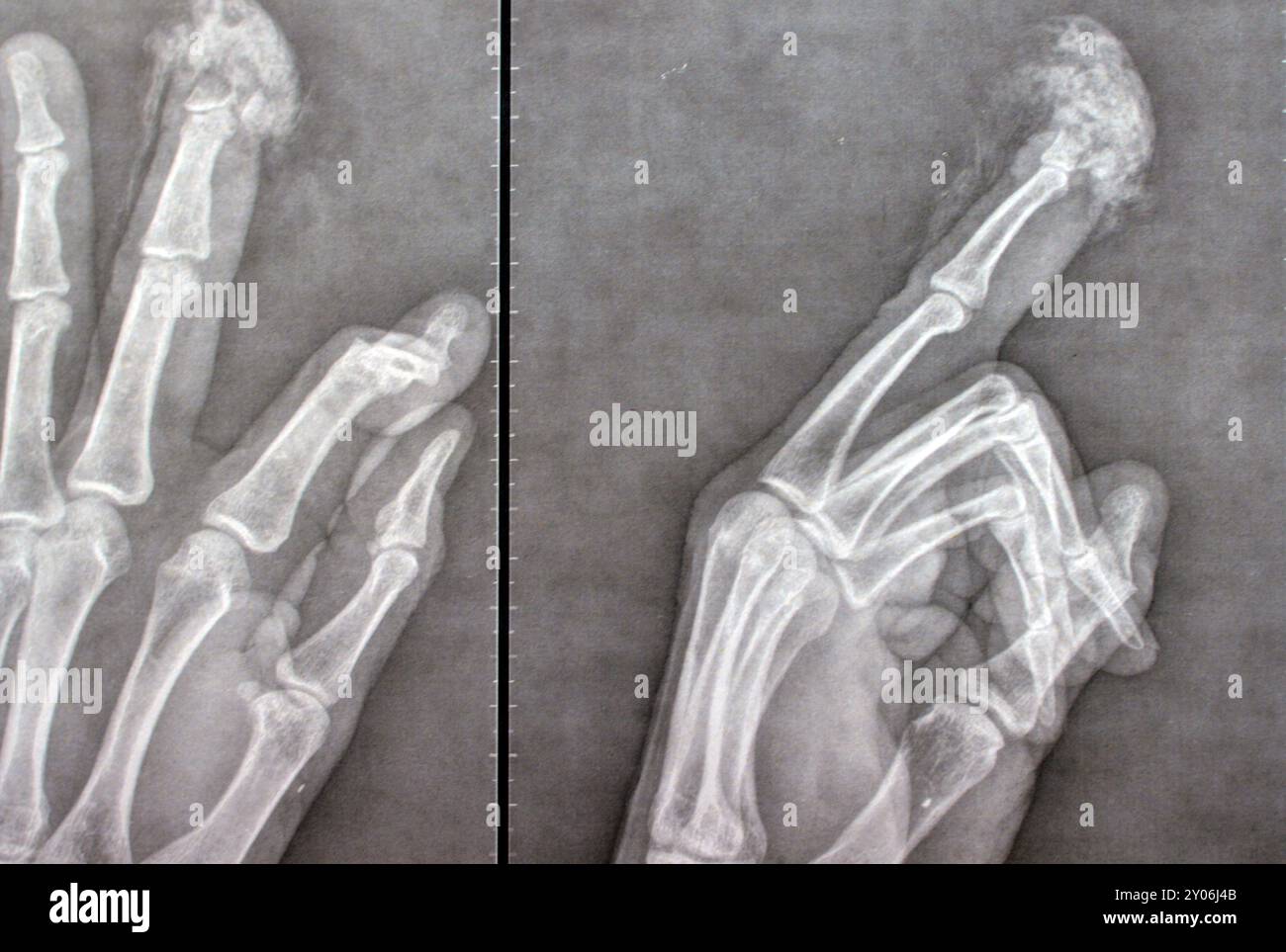 Plain X-Ray reveals distal tip amputation of distal phalanx of the ...