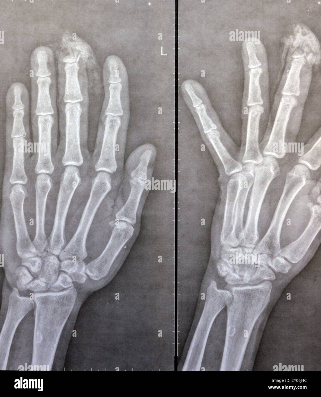 Plain X-Ray reveals distal tip amputation of distal phalanx of the ...