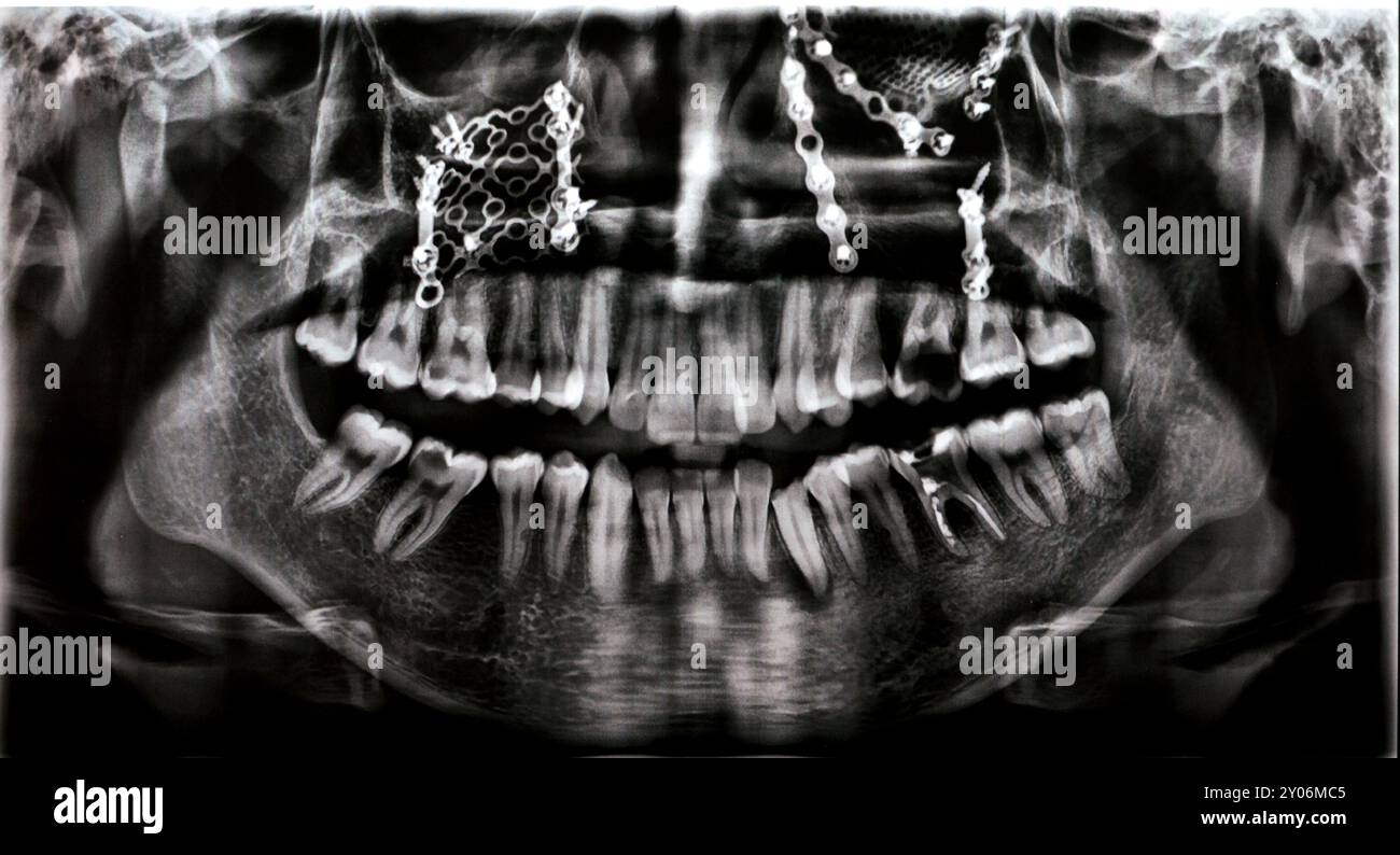 Panoramic X Ray shows multiple plates, screws for maxillary fixation of ...