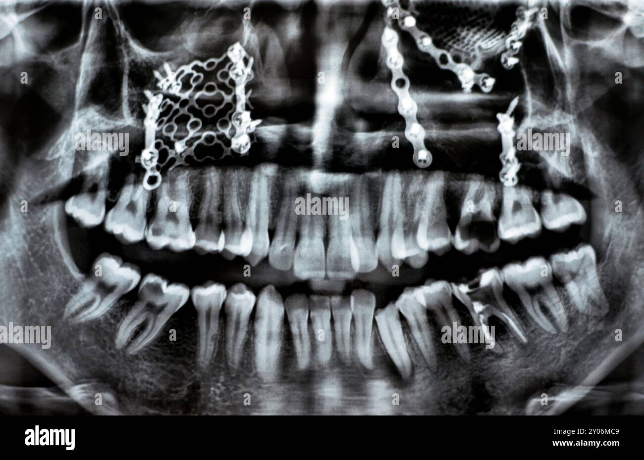 Panoramic X Ray shows multiple plates, screws for maxillary fixation of ...