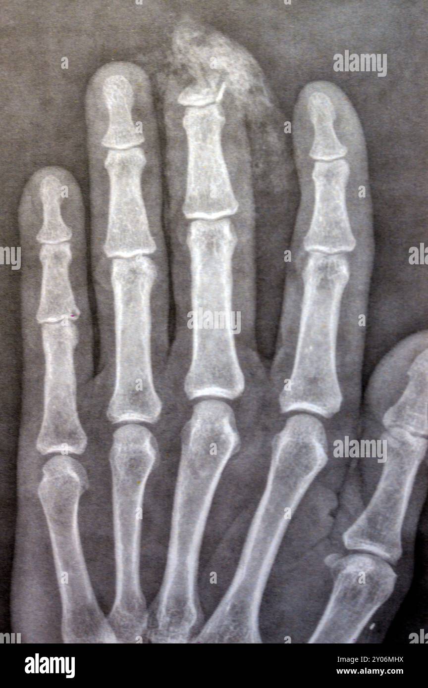 Plain X-Ray reveals distal tip amputation of distal phalanx of the middle finger of the left ...