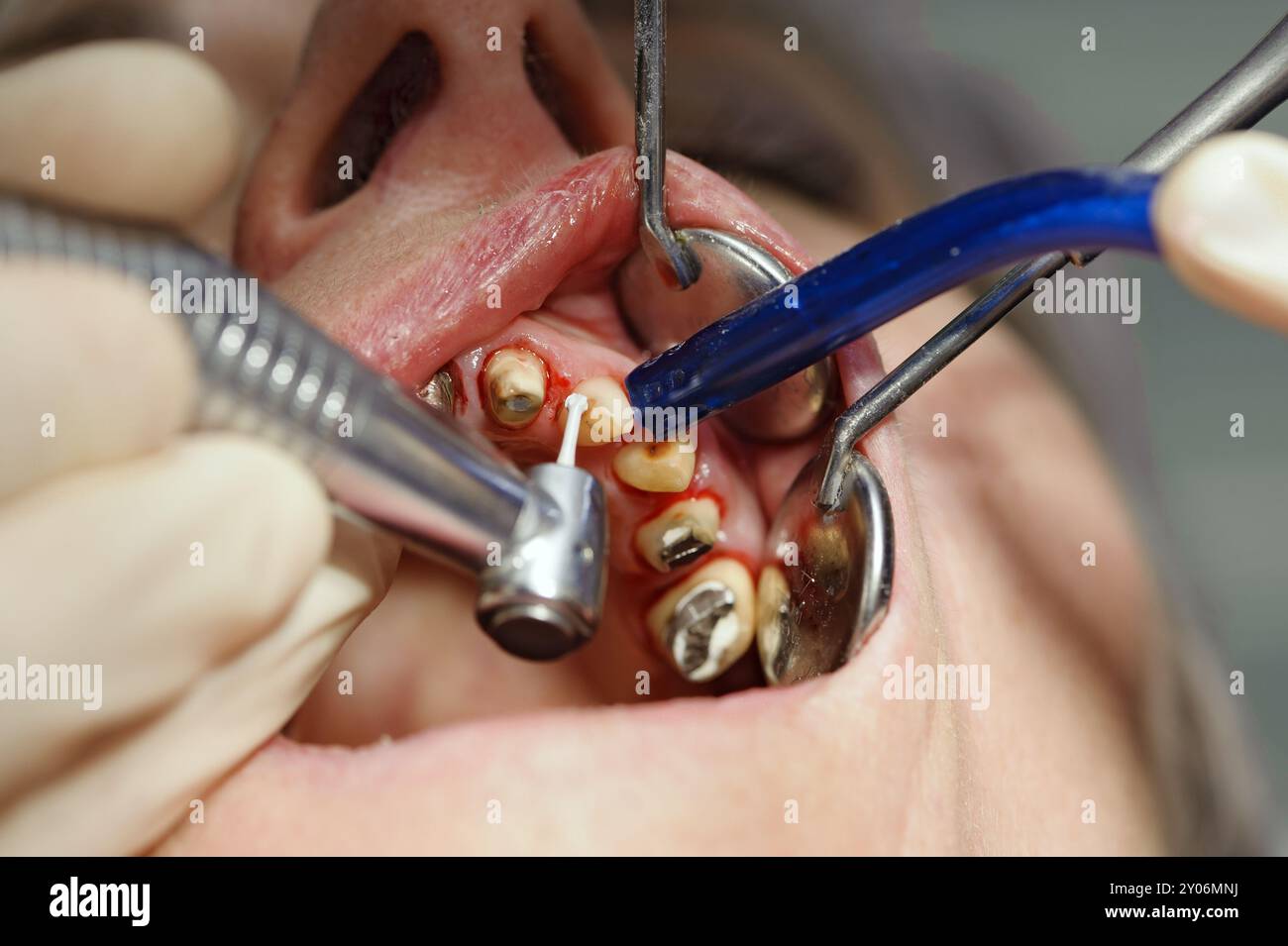 Preparation of the tooth stumps for the new crowns Stock Photo - Alamy