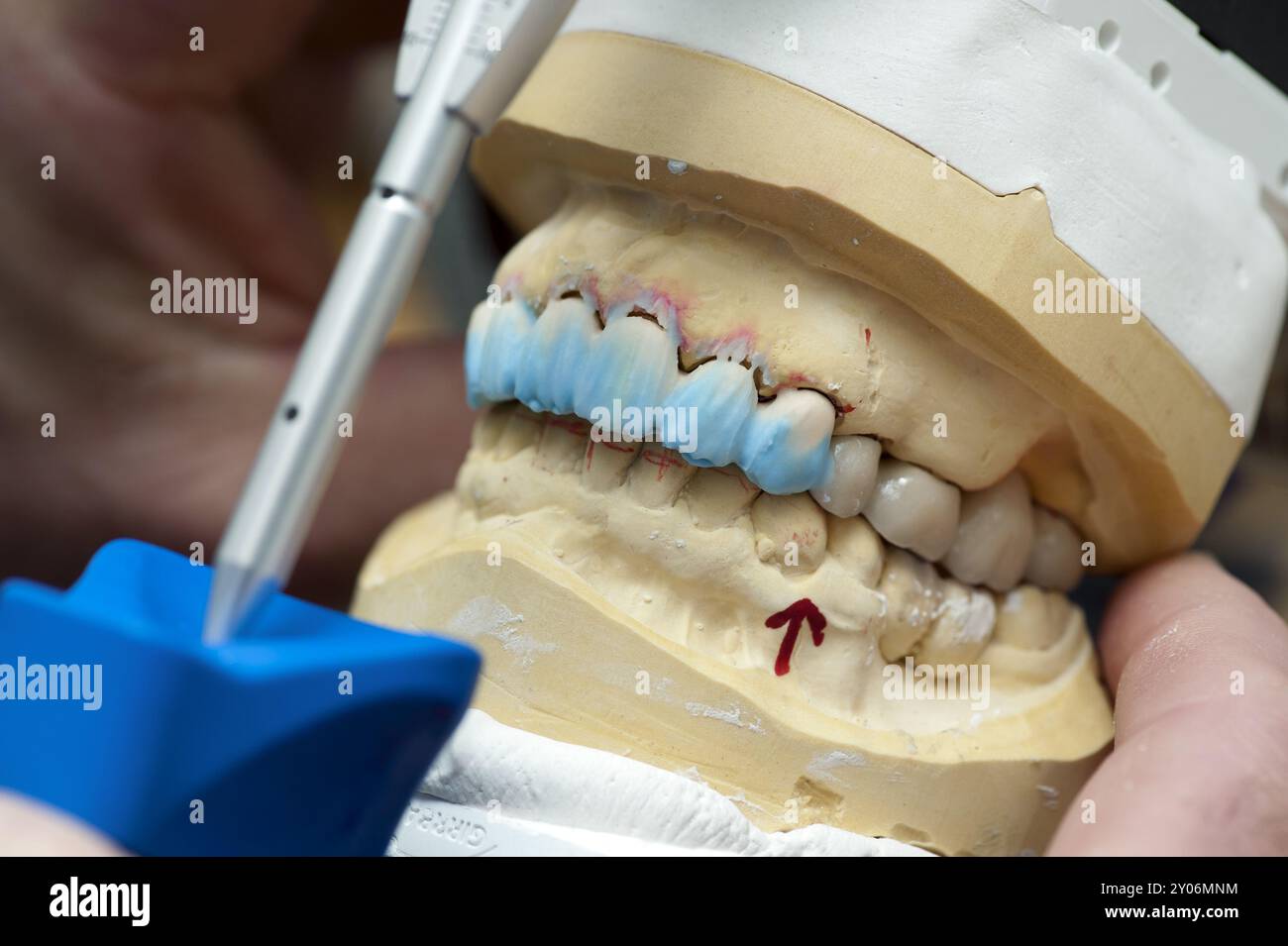 Coloured ceramic crowns in the upper jaw model Stock Photo - Alamy