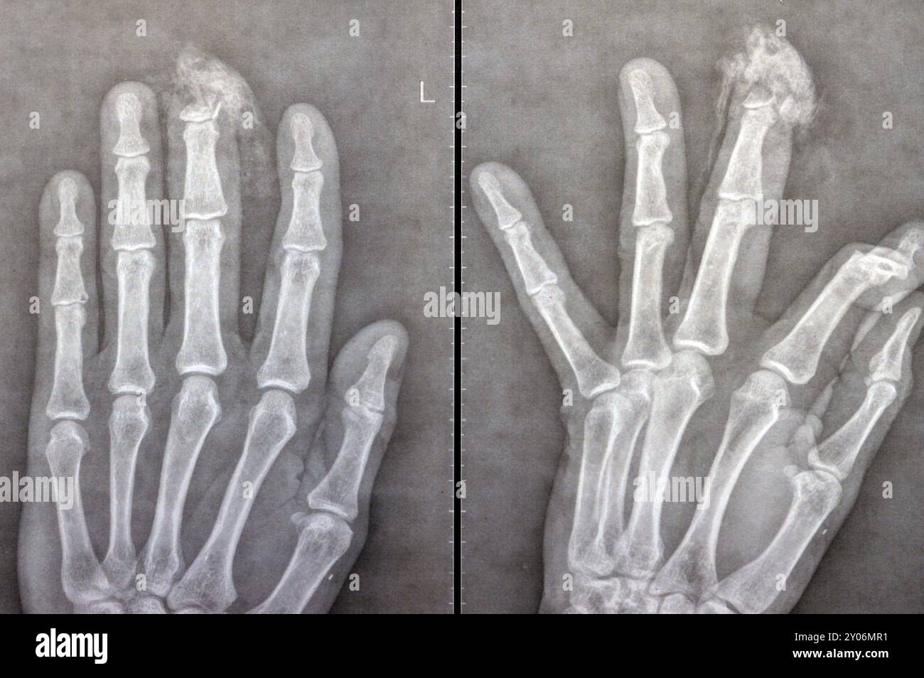 Plain X-Ray reveals distal tip amputation of distal phalanx of the ...