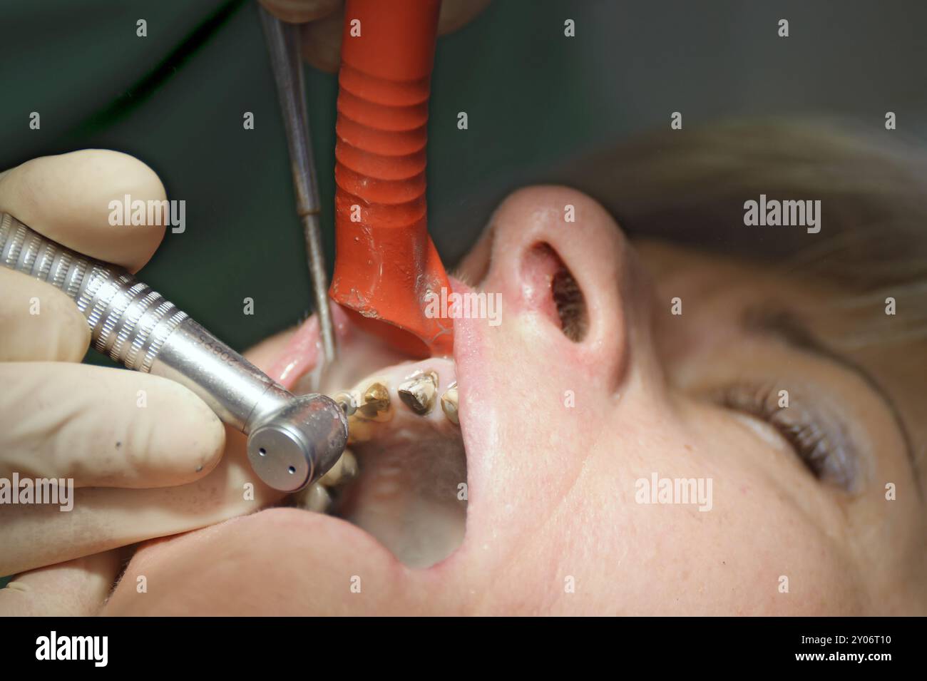 Drilling teeth tooth dentist hi-res stock photography and images - Alamy