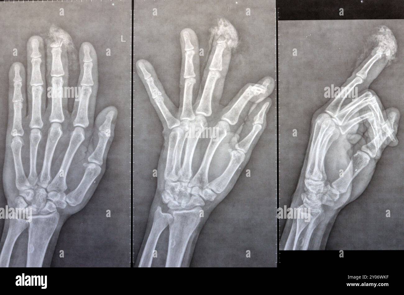 Amputation cut injury finger hi-res stock photography and images - Alamy