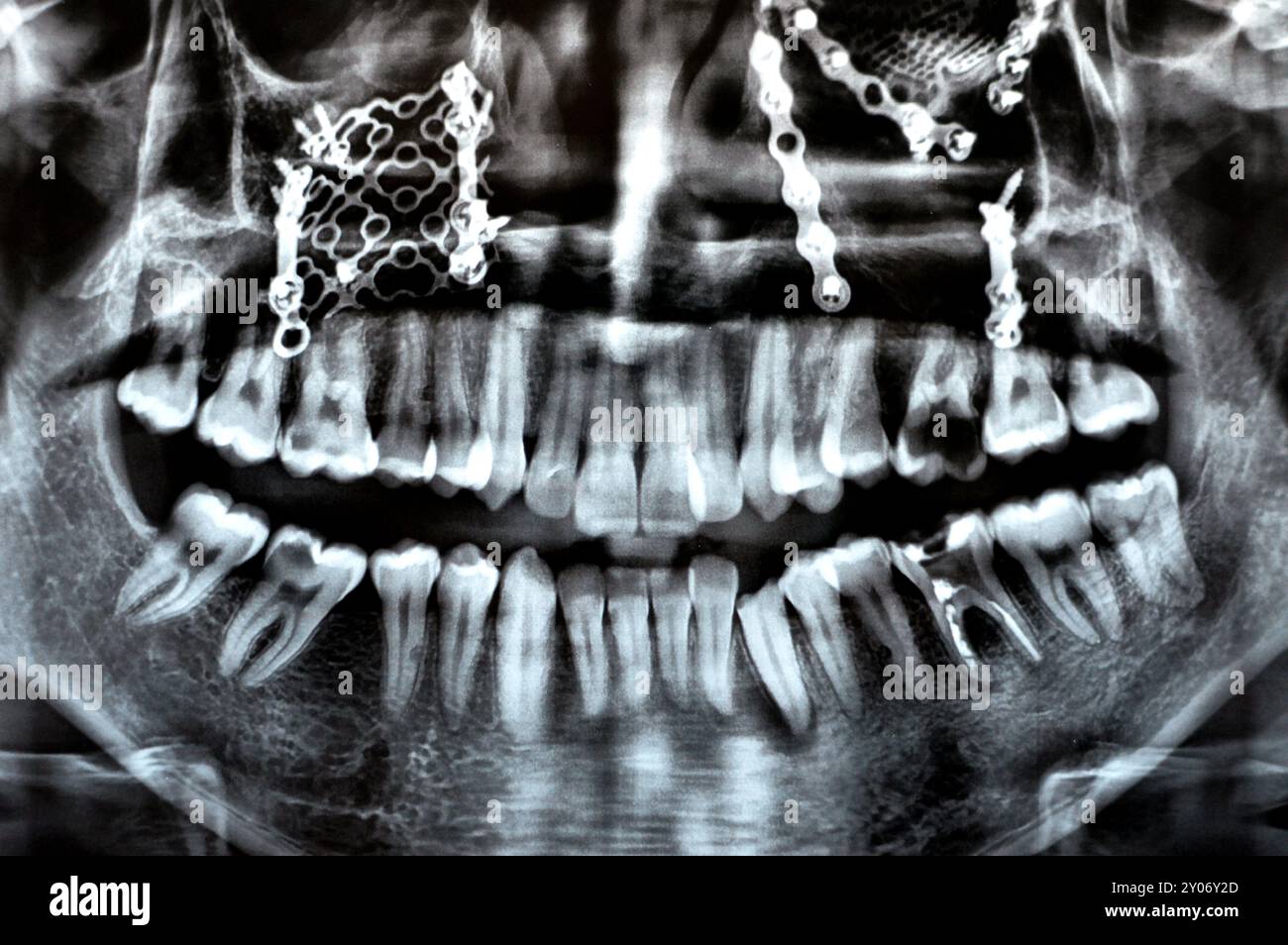 Panoramic X Ray shows multiple plates, screws for maxillary fixation of ...