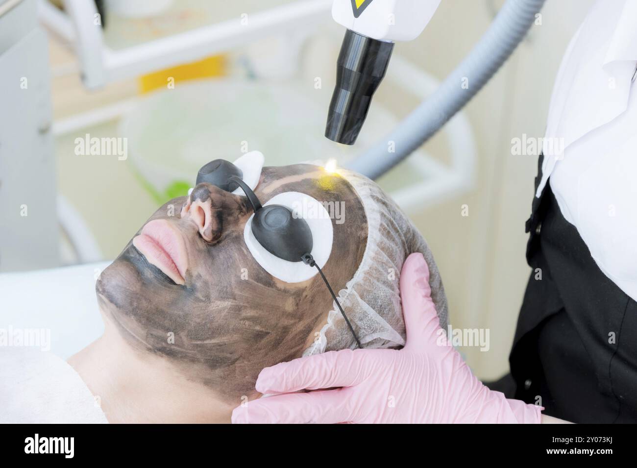 Close-up carbon face peeling procedure. Laser pulses clean skin of the ...