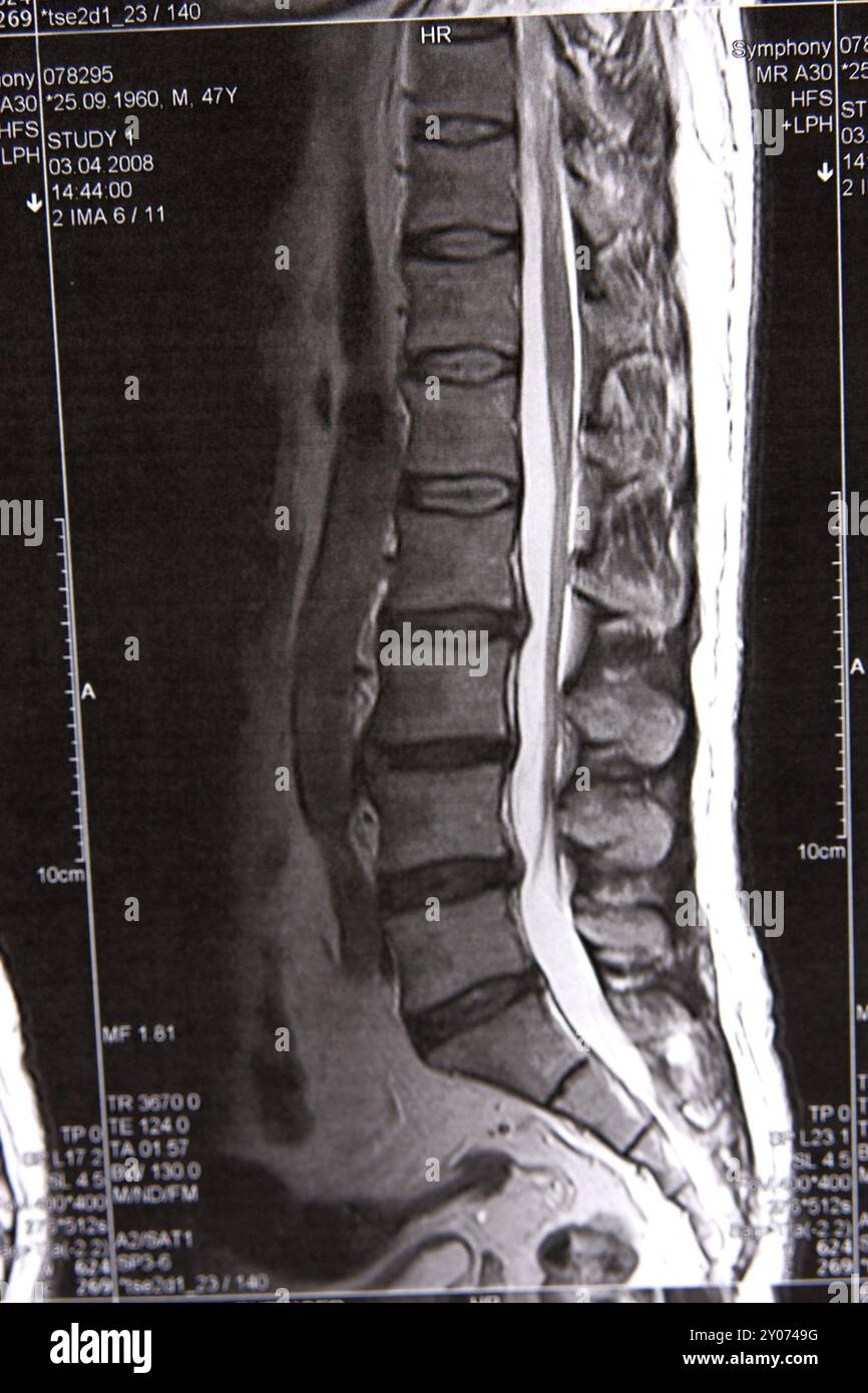 Mri slipped disc hi-res stock photography and images - Alamy