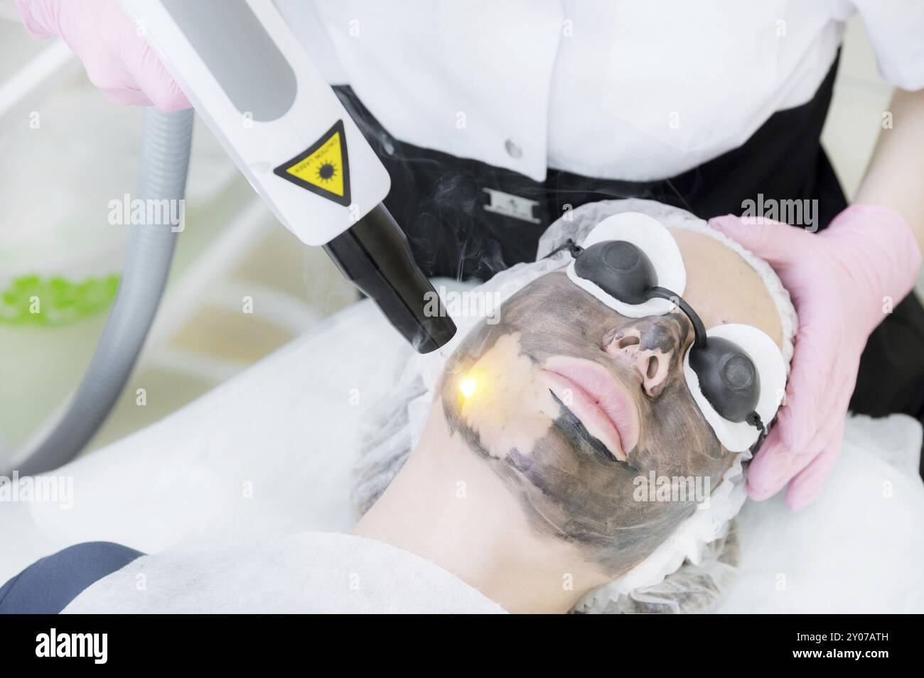 Close-up carbon face peeling procedure. Laser pulses clean skin of the ...