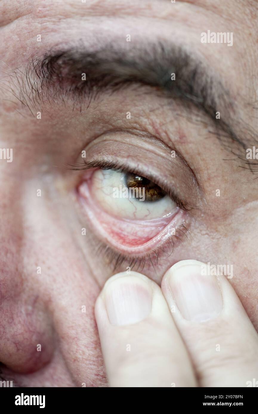 Fingers pull eyelid downwards Stock Photo - Alamy
